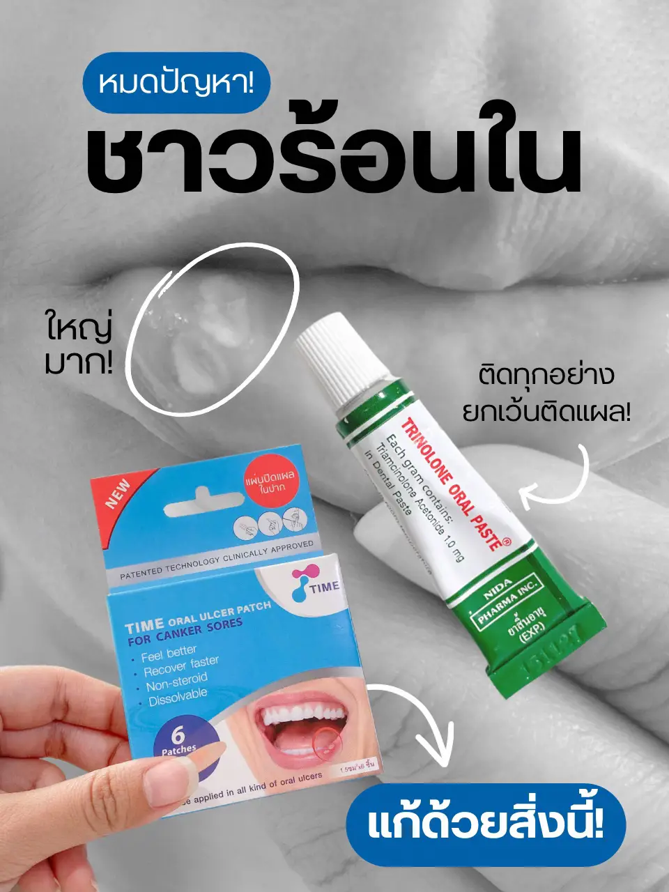 หมดปัญหา ยาแก้ร้อนในติดทุกอย่างยกเว้นติดแผล แก้ได้ด้วย…🫦🩹 แกลเลอรี