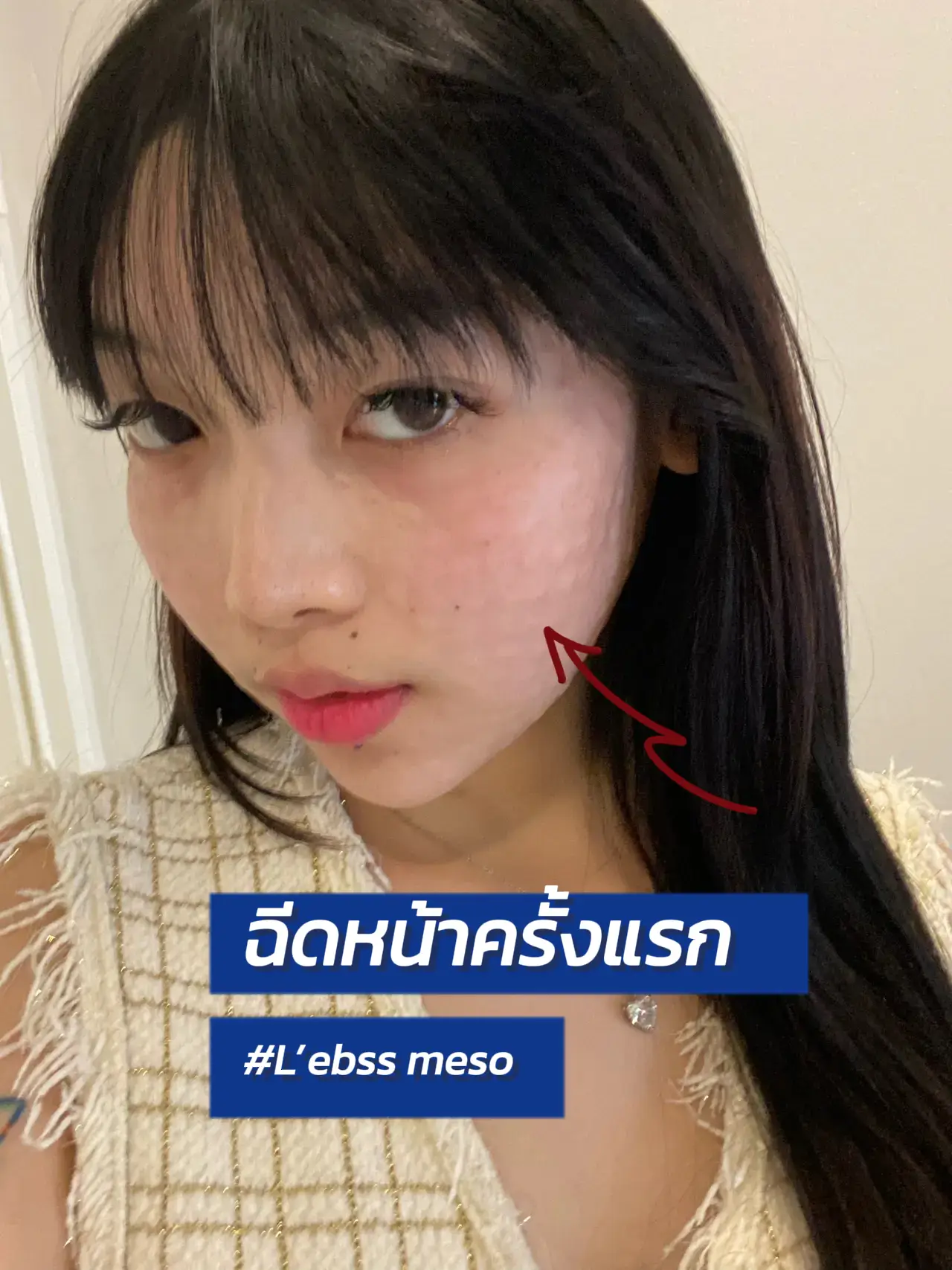 ฉีดหน้าครั้งแรก L’bess Meso | แกลเลอรีที่โพสต์โดย Babyarpo | Lemon8