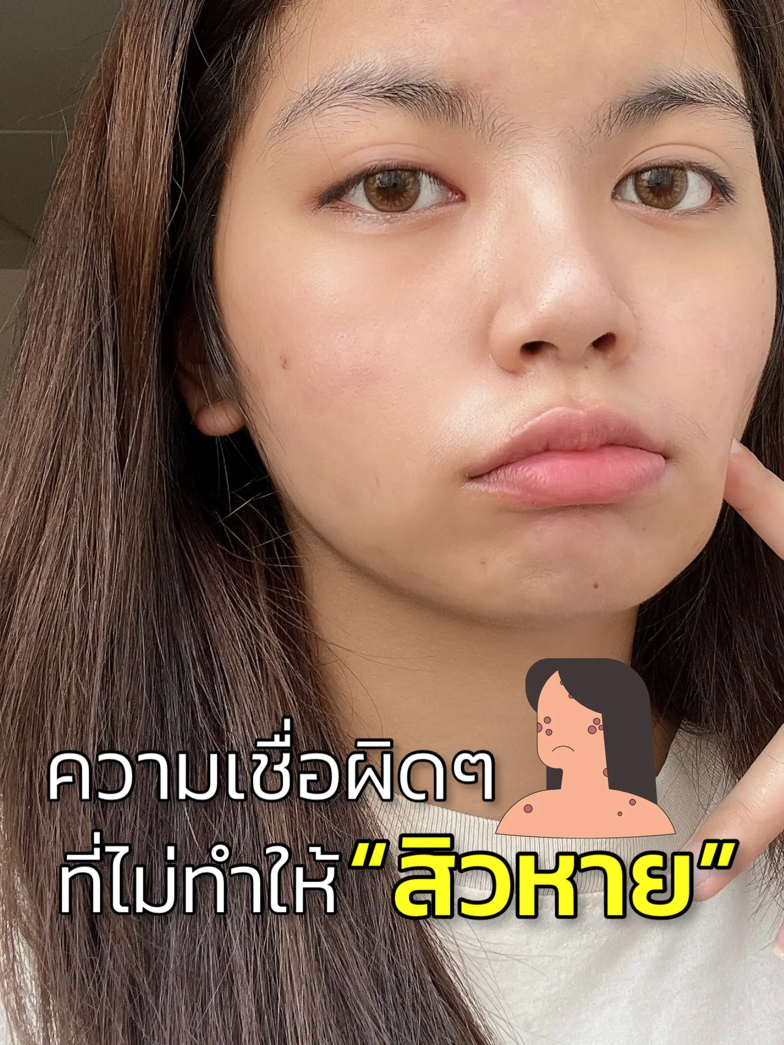 3 ความเชื่อผิดๆ ที่ไม่ทำให้ “สิวหาย” | แกลเลอรีที่โพสต์โดย Kkacha | Lemon8