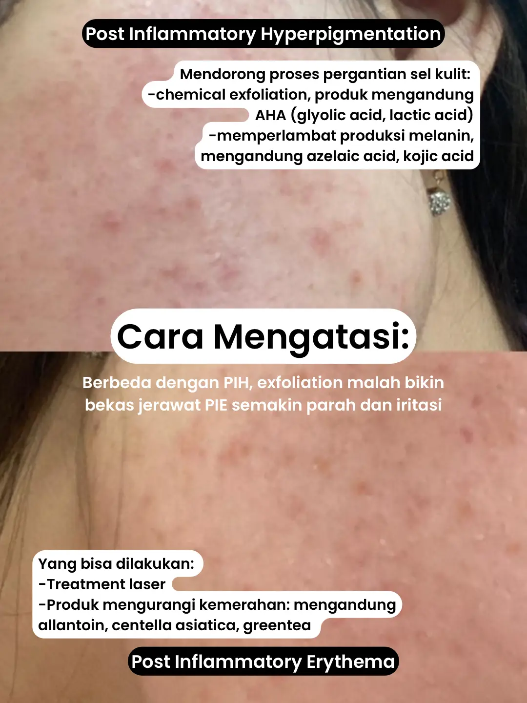 Bekas Jerawat: PIE vs PIH? Apa bedanya?🤔 | Galeri diposting oleh ruthdaniela | Lemon8
