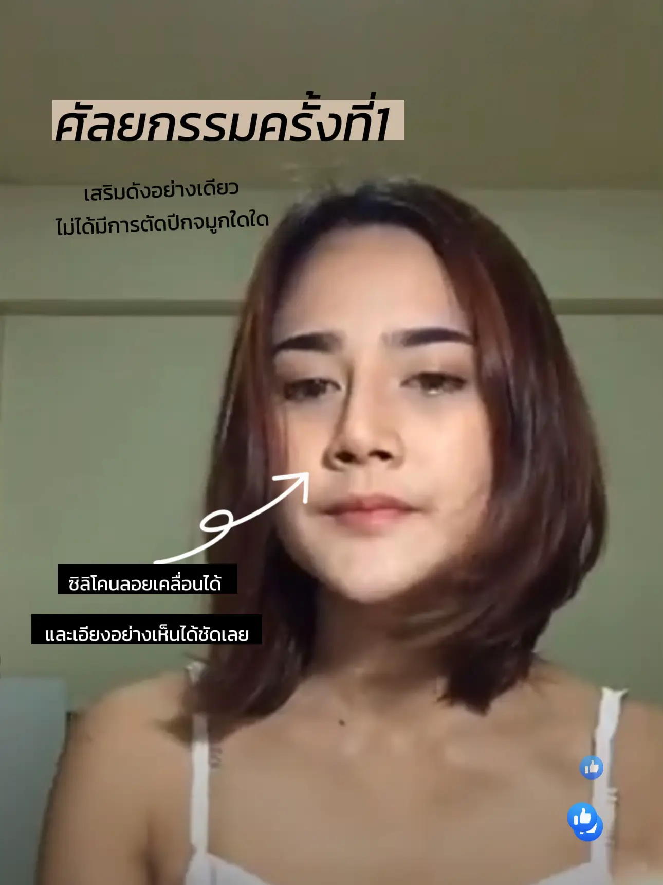 แก้จมูกรอบ2ปังหรือตุบมาดูกัน | แกลเลอรีที่โพสต์โดย Napatch.kat | Lemon8