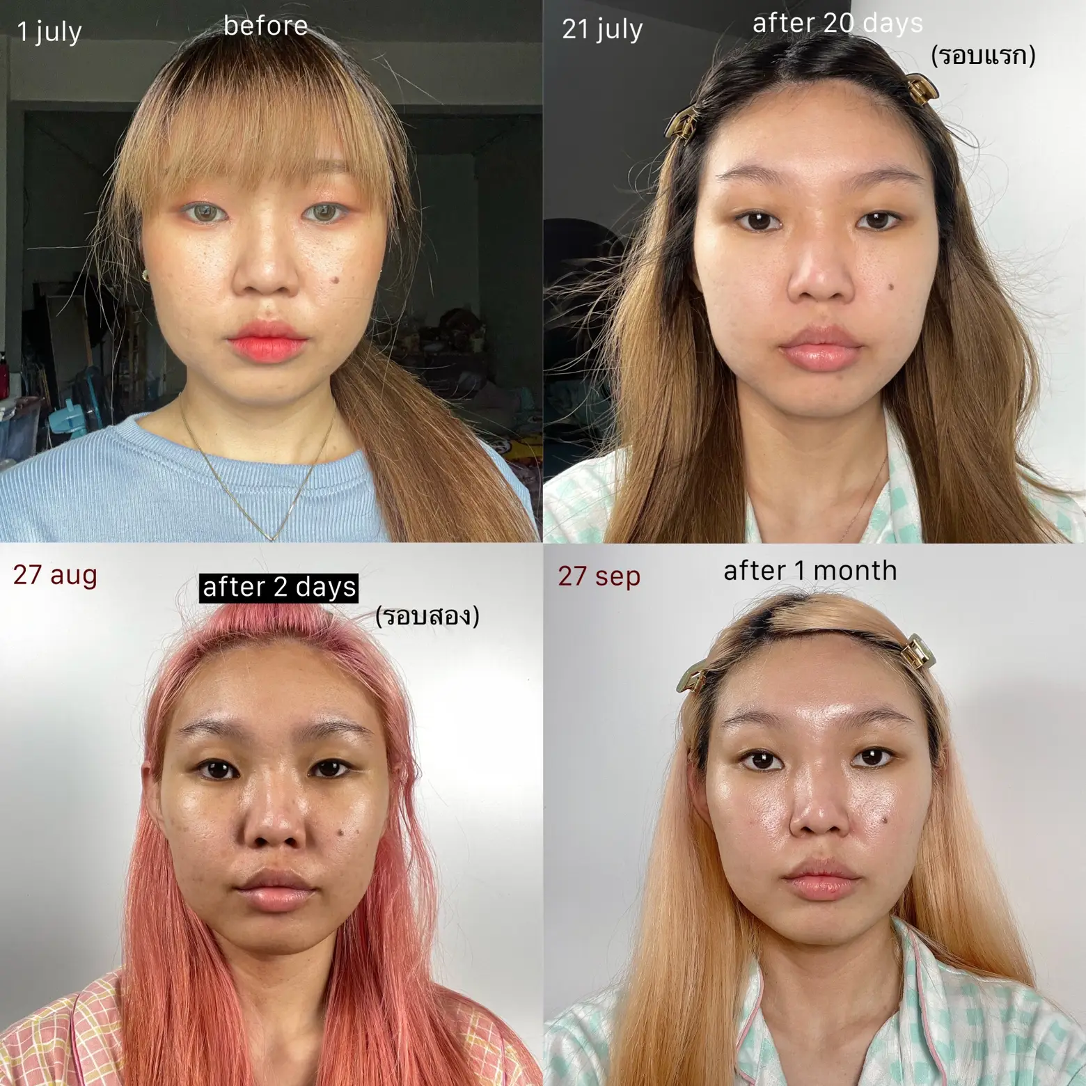 รีวิวละเอียดยิบครั้งแรกกับ botox + fat bomb 👀🌟🏏 | แกลเลอรีที่โพสต์โดย ...