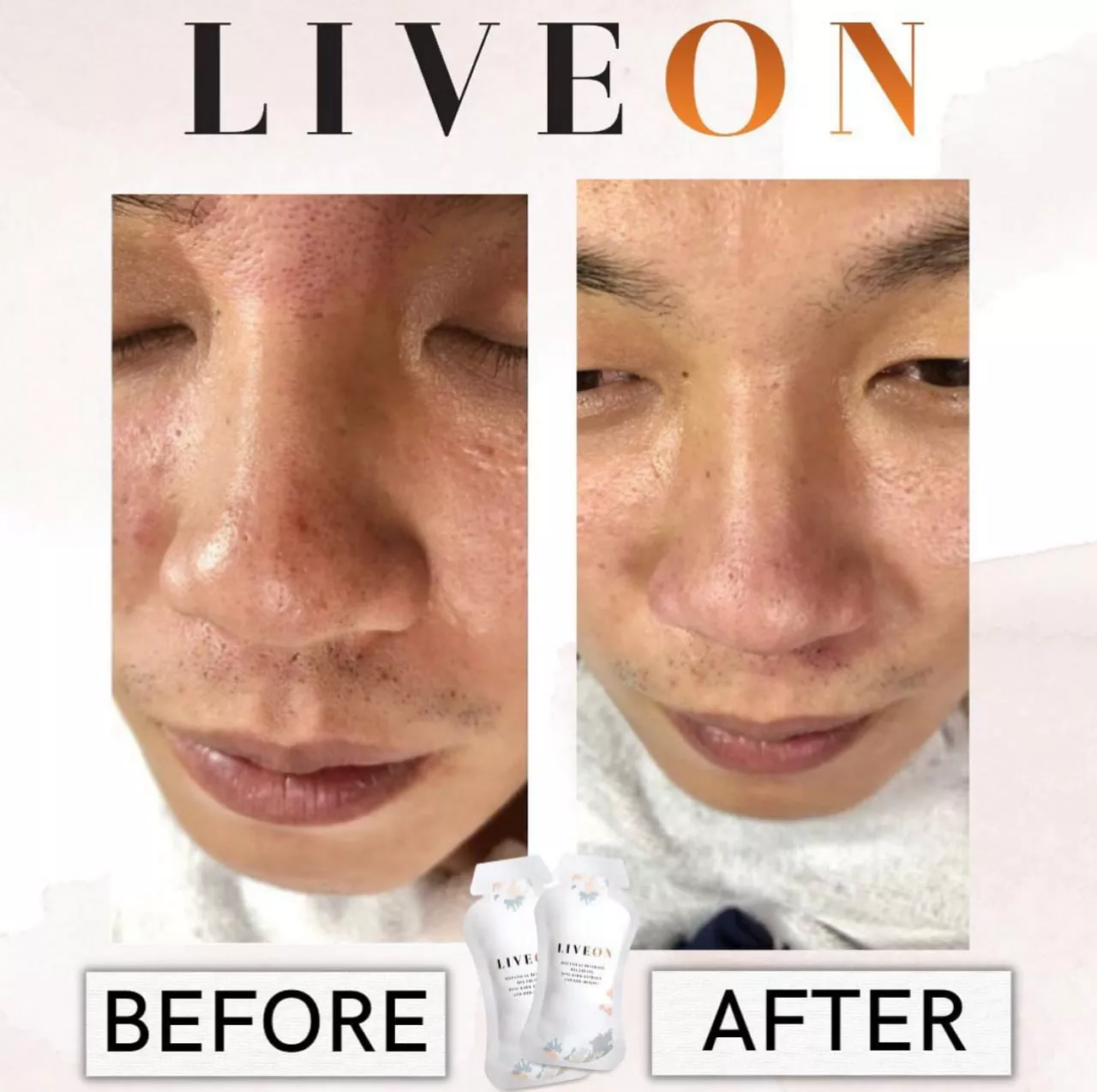 Know why there are pimples on | Galeri disiarkan oleh 1grp_Stella97gu | Lemon8