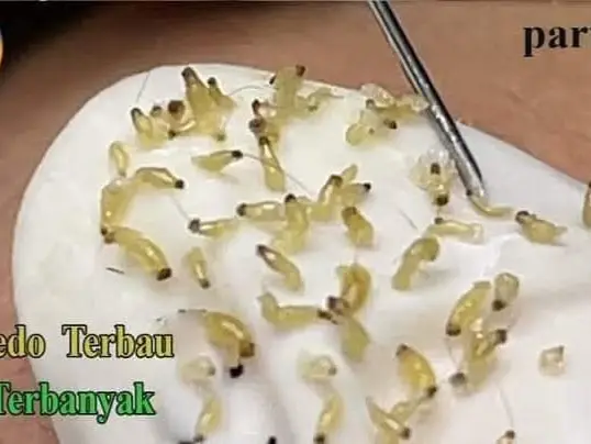 19 ide cara mengatasi komedo tertutup teratas di 2024