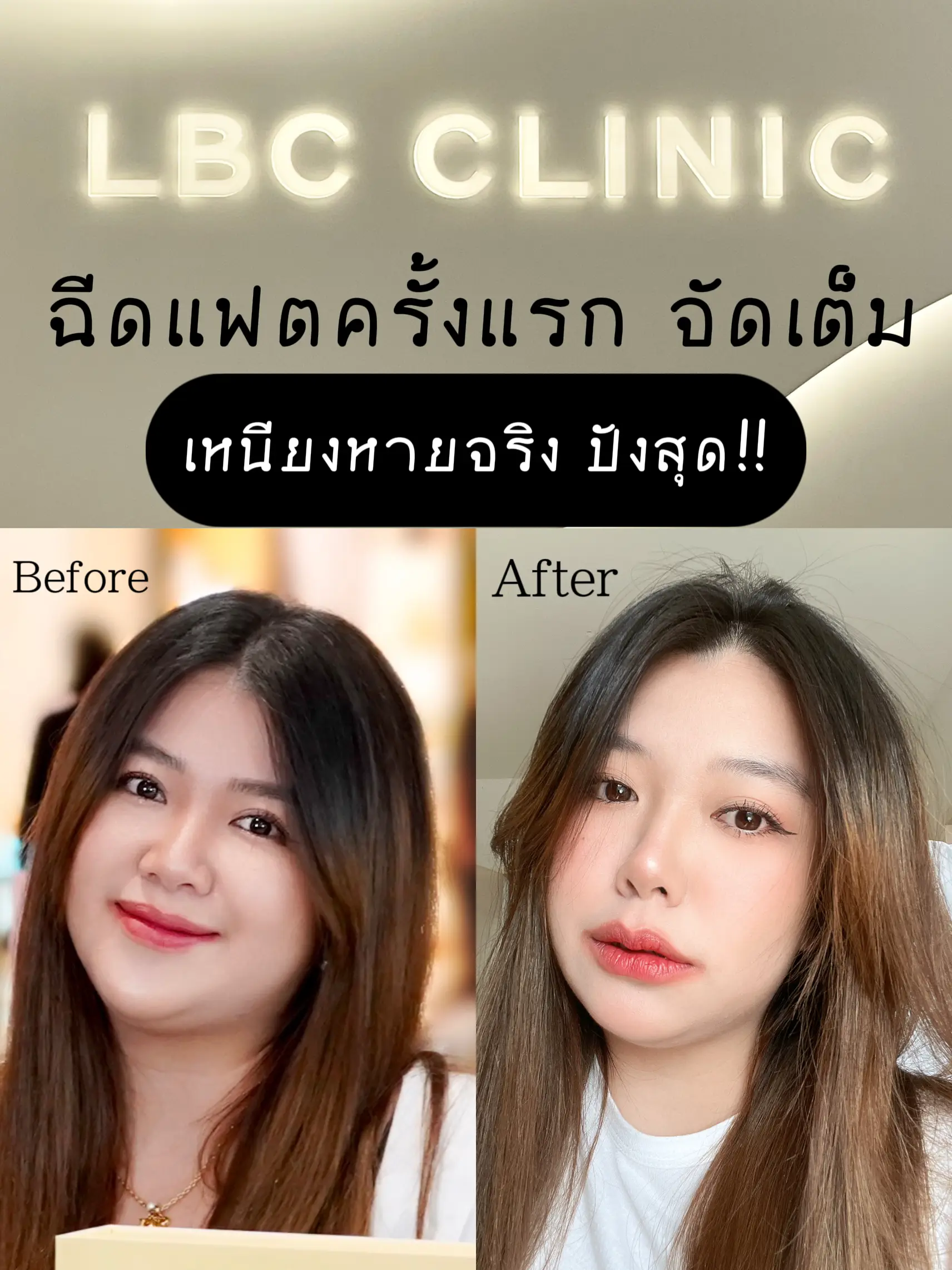 ฉีดแฟตหน้า เหนียง lbc - การค้นหาใน Lemon8