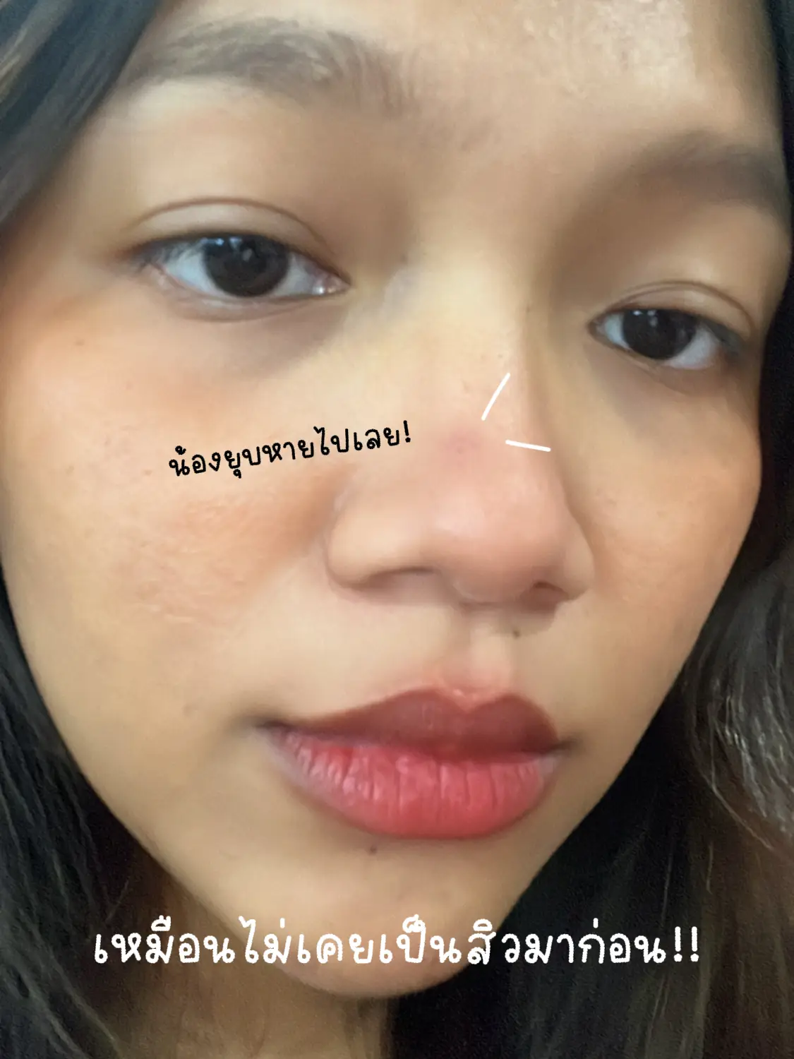 🪄 เสกสิวยุบภายในคืนเดียว!! | แกลเลอรีที่โพสต์โดย Fewii🌈 | Lemon8