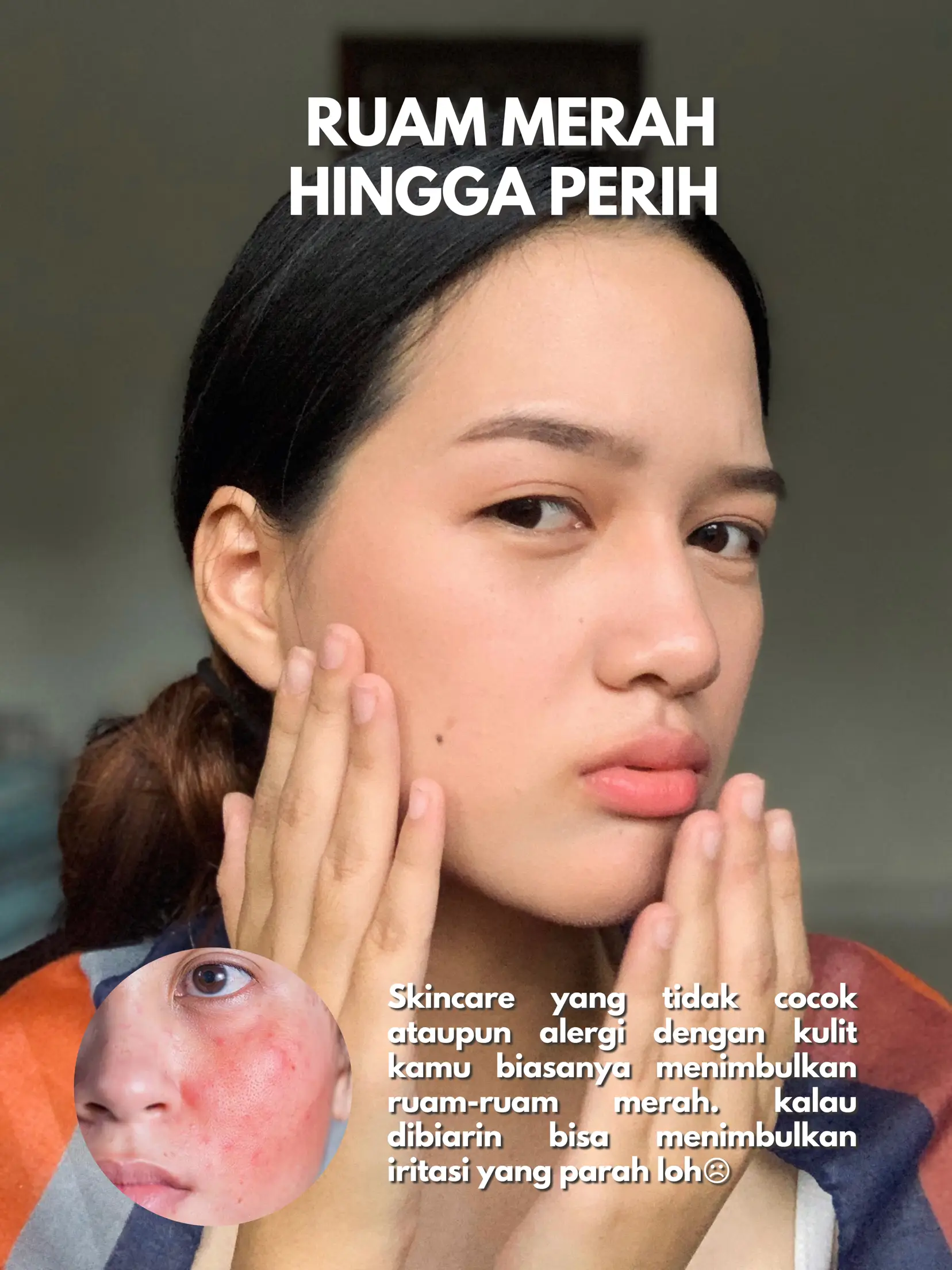 Kenali tanda tidak cocok skincare! | Galeri diposting oleh jane | Lemon8