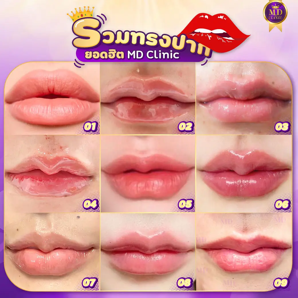 📌🫦รวมทรงปากยอดฮิต 💄💥 | แกลเลอรีที่โพสต์โดย Md clinic | Lemon8
