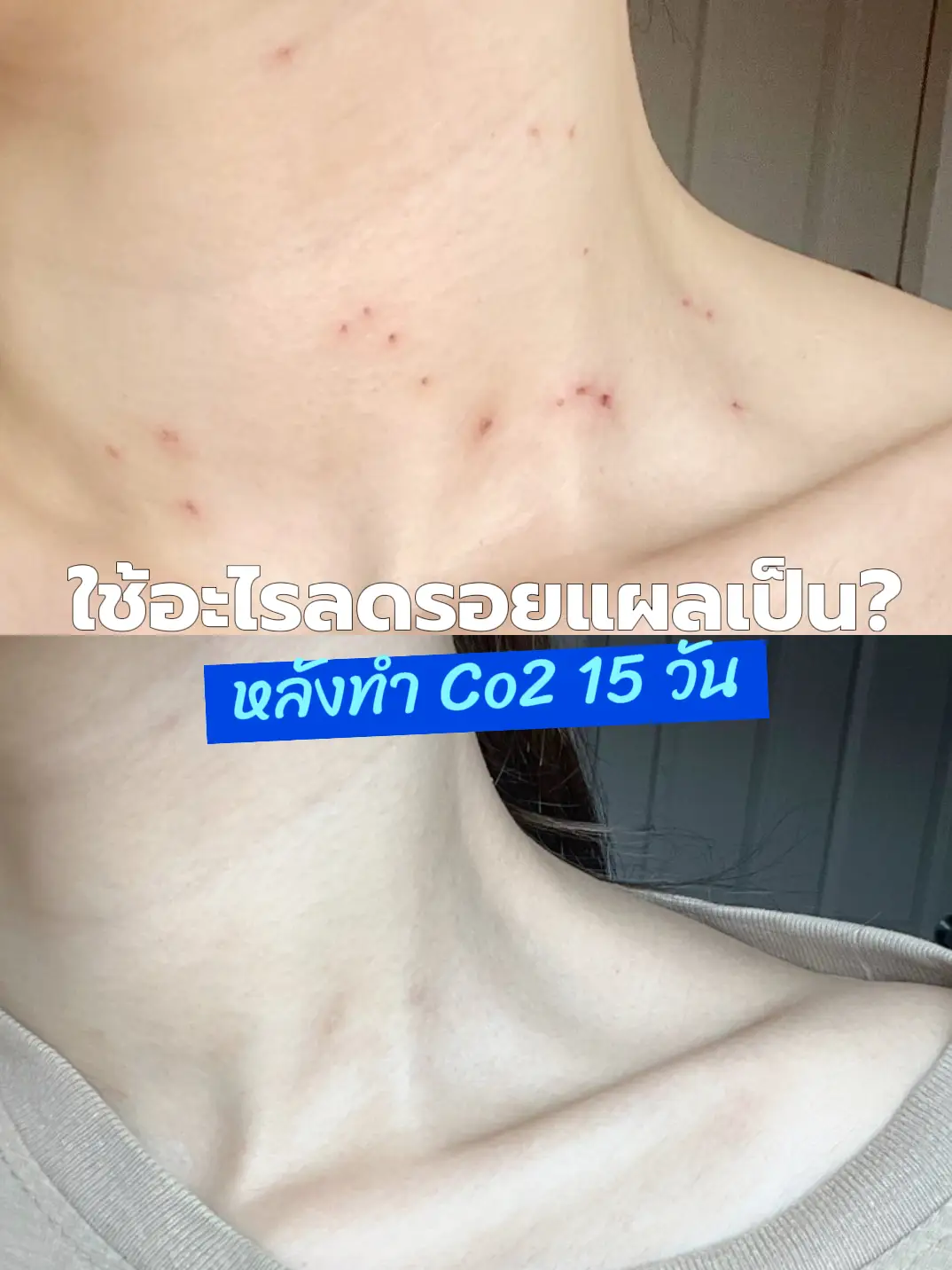ใช้อะไรลดรอยแผลเป็น? อัพเดตหลังทำCo2 15 วัน🚨 | แกลเลอรีที่โพสต์โดย เพลงว่าดี | Lemon8
