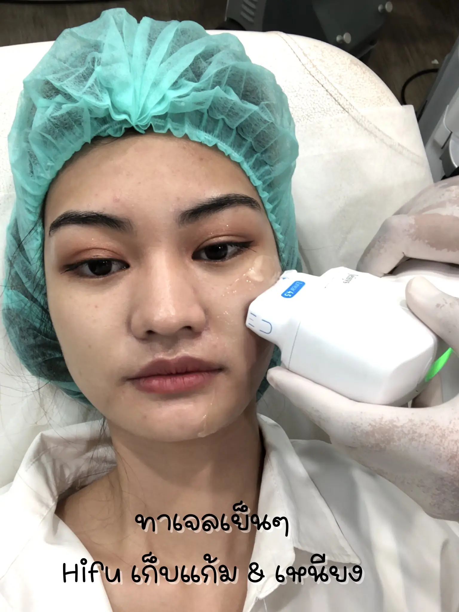 Hifu หน้าเรียว เก็บเหนียง งบ 899 บาท คุ้ม! | แกลเลอรีที่โพสต์โดย Ferngloryy | Lemon8