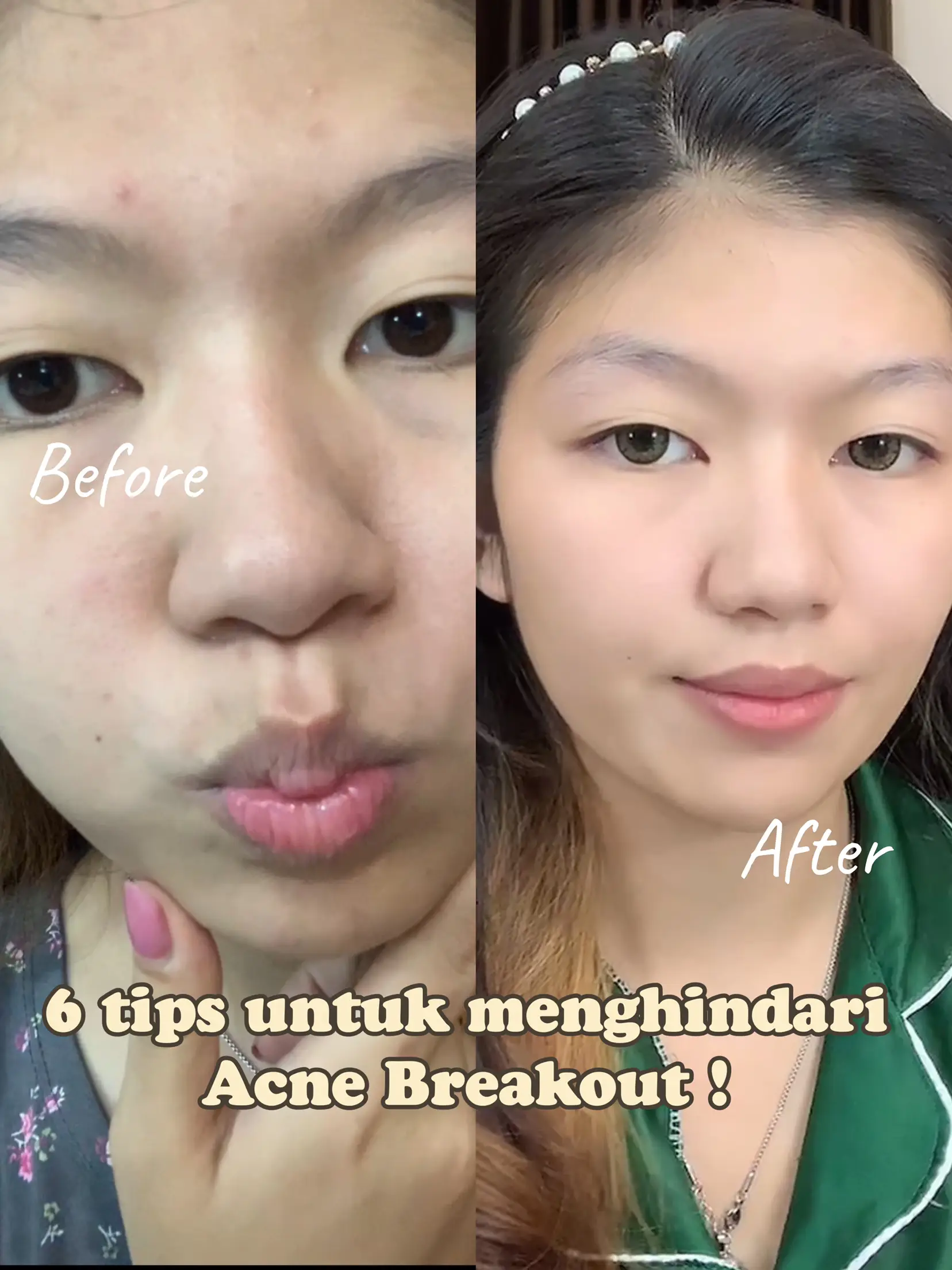 6 Tips untuk menghindari acne breakout ! | แกลเลอรีที่โพสต์โดย Josephine.hr | Lemon8