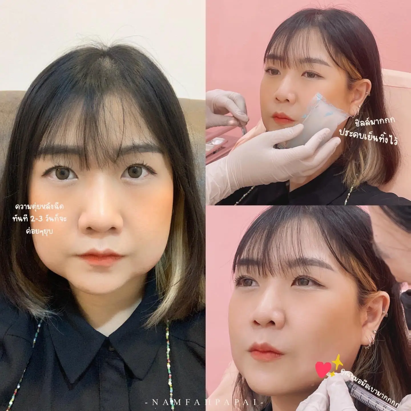 รีวิวlipocaffเมโสแฟตสลายไขมัน - การค้นหาใน Lemon8