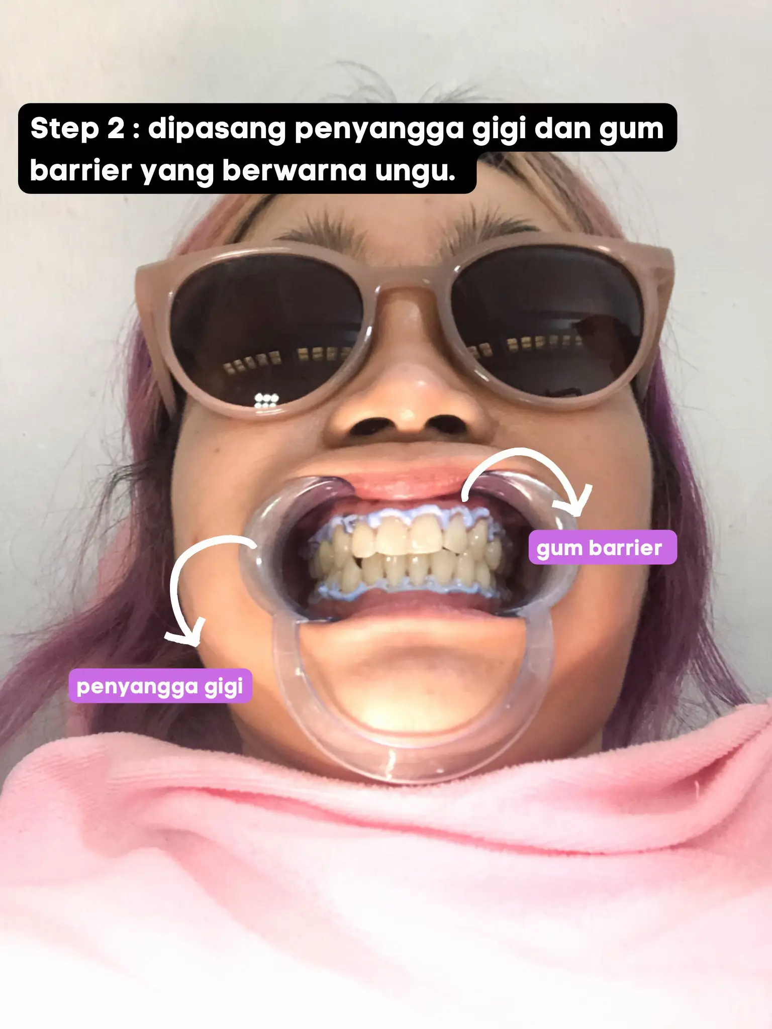 BLEACHING GIGI GRATIS!! | Galeri diposting oleh Yuka | Lemon8