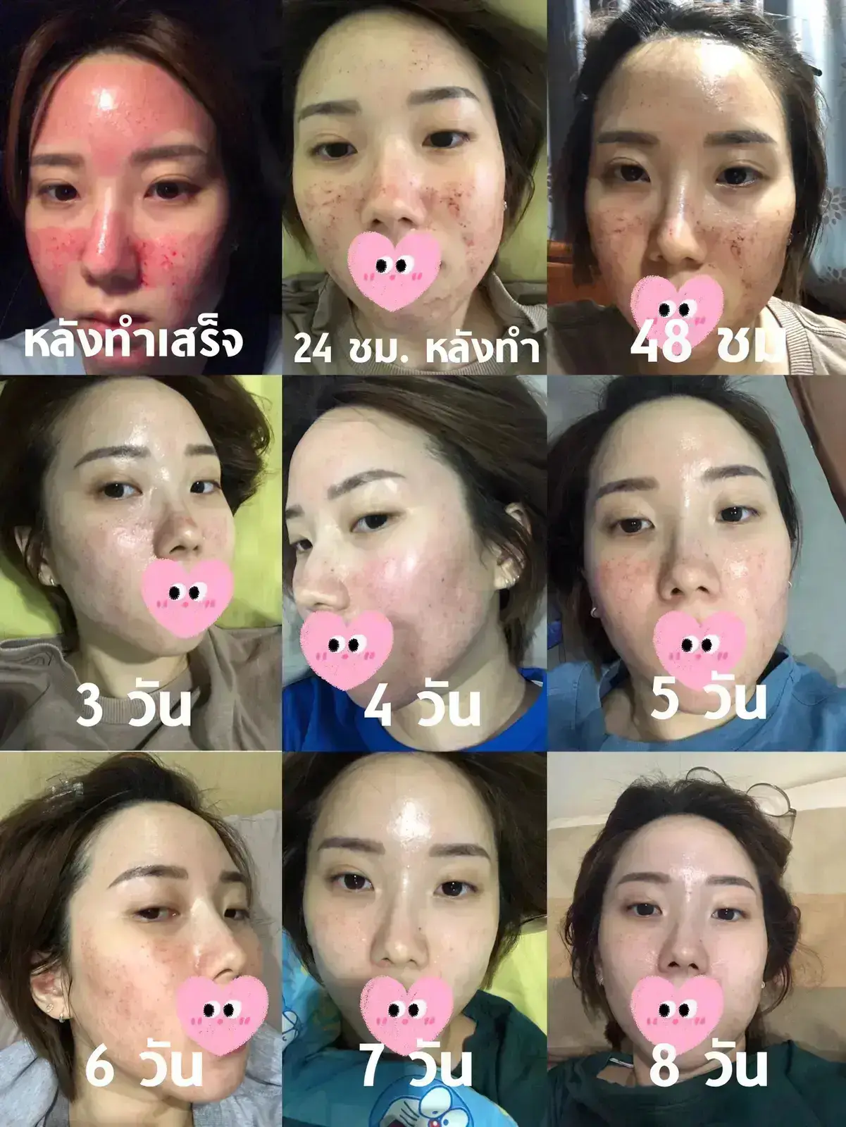 รีวิว PICO LASER หน้าใส | แกลเลอรีที่โพสต์โดย Themetema | Lemon8