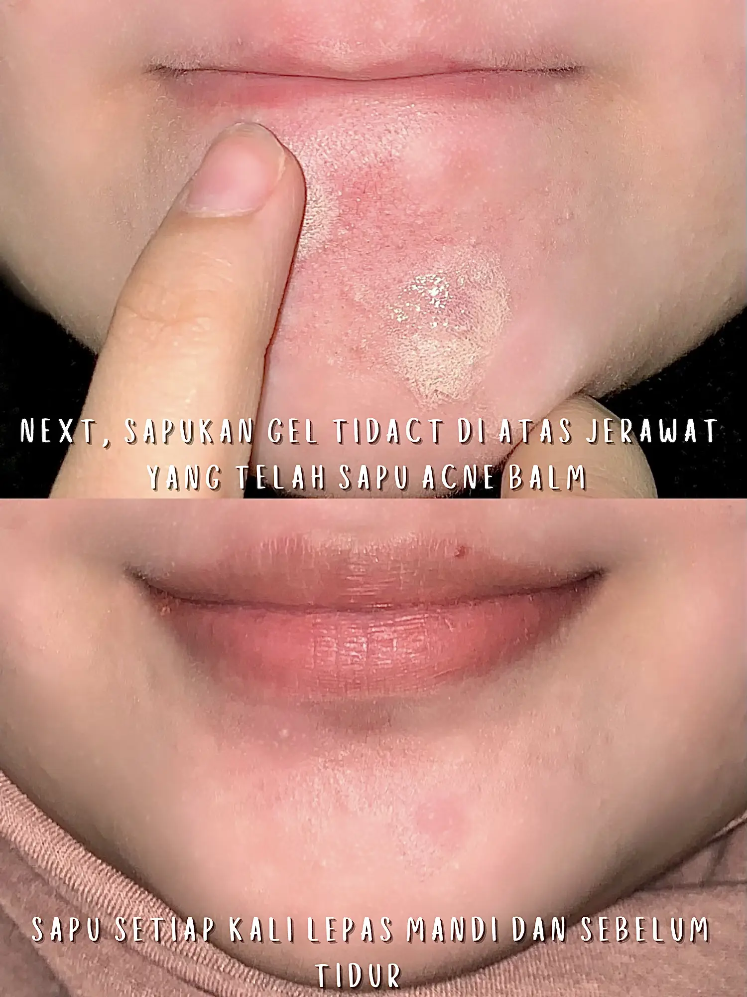 how i do acne treament at home | Galeri disiarkan oleh Yasmin Aminin ...