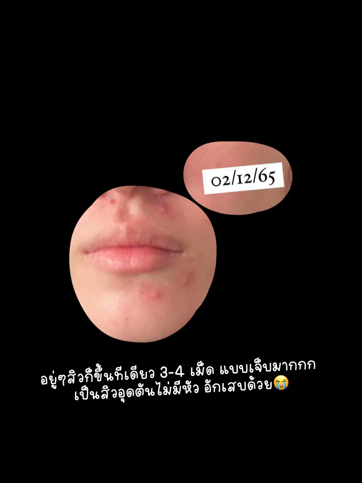 รักษาสิวใน 5 วัน (ฉบับสิวไม่เยอะ) 🌟 | แกลเลอรีที่โพสต์โดย mp | Lemon8