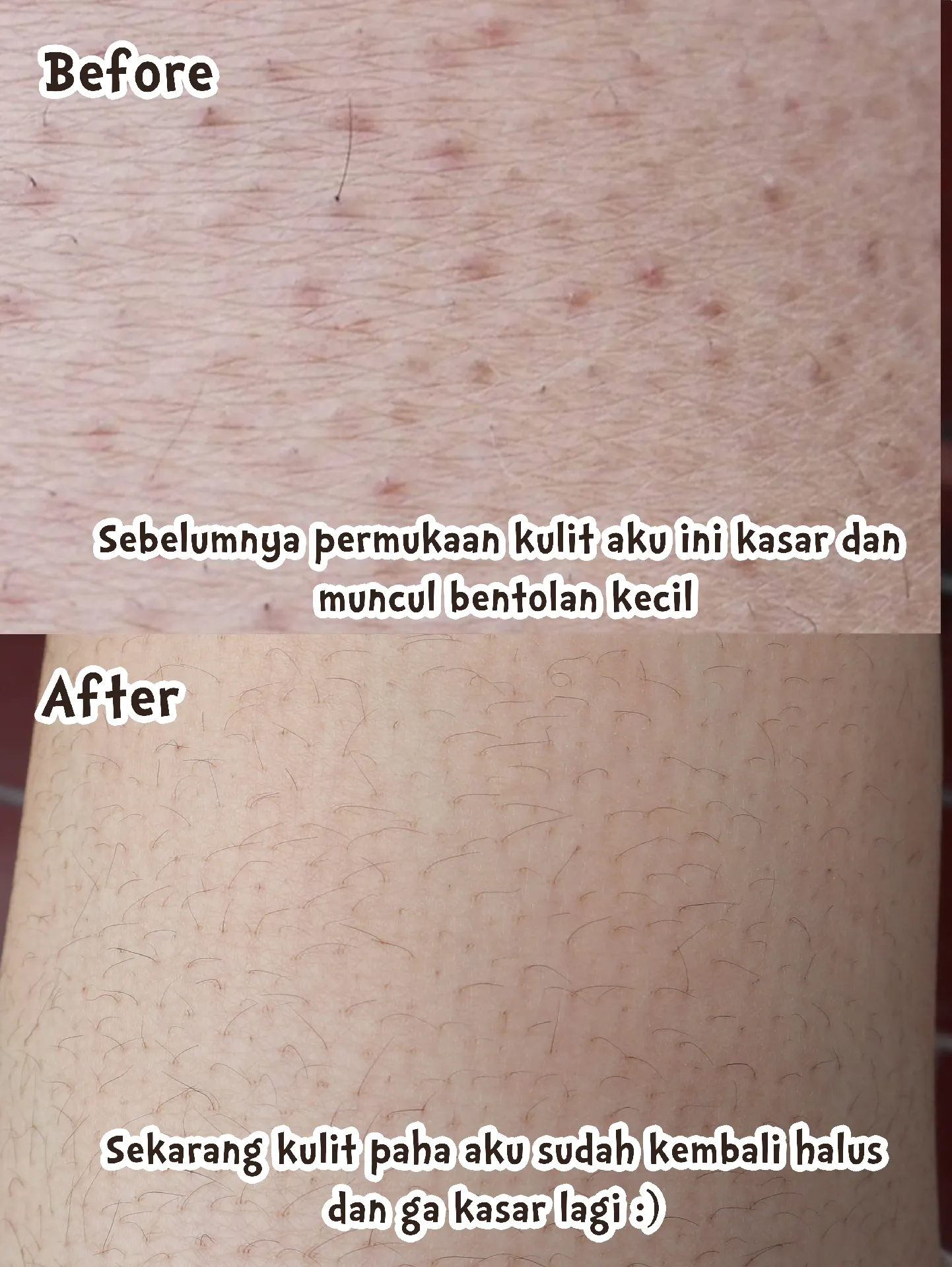 Cara Mudah Hilangkan Chicken Skin🥺👍 | Galeri diposting oleh ...