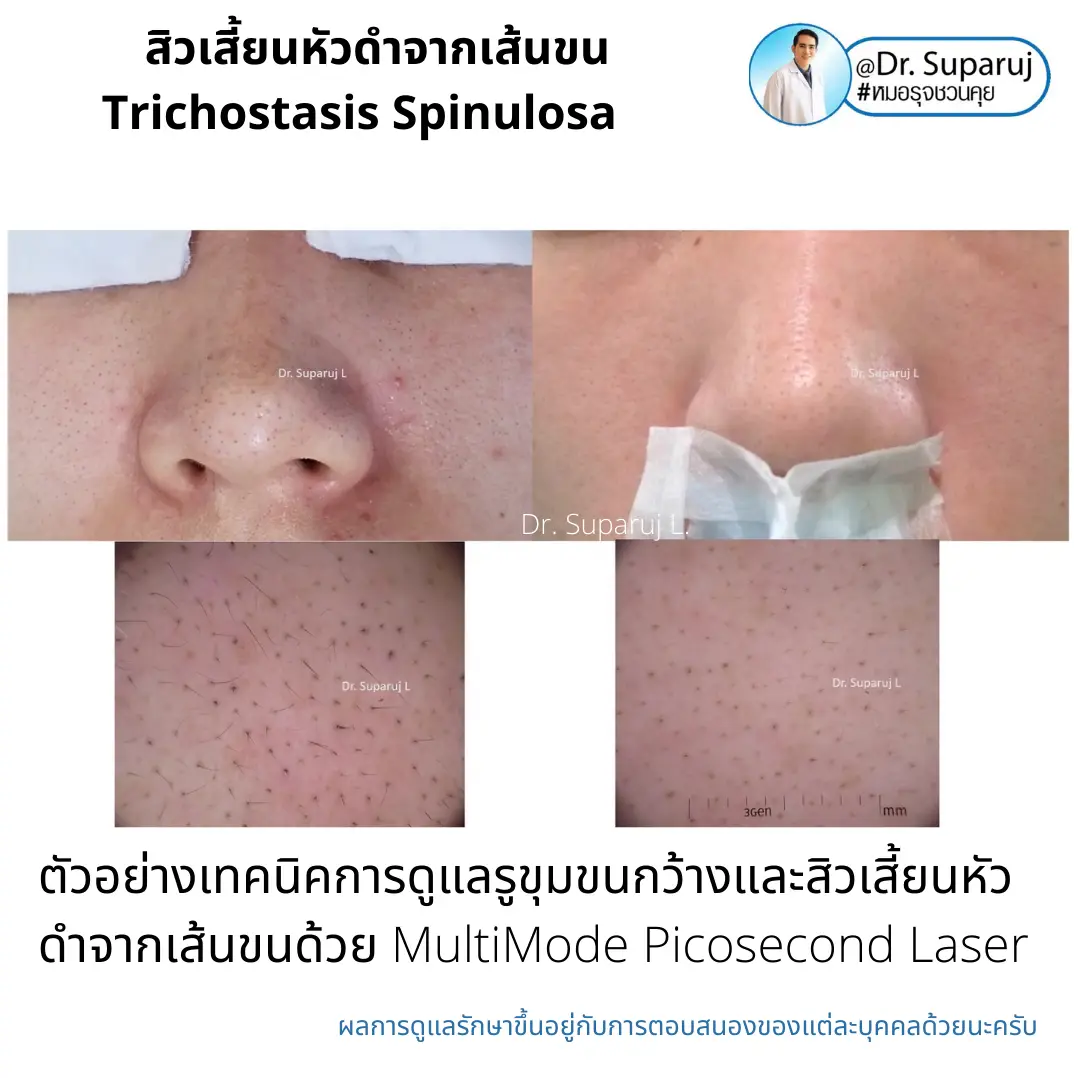 Black-headed splinter wide pore from Trichostasis spinulosa hair line ...