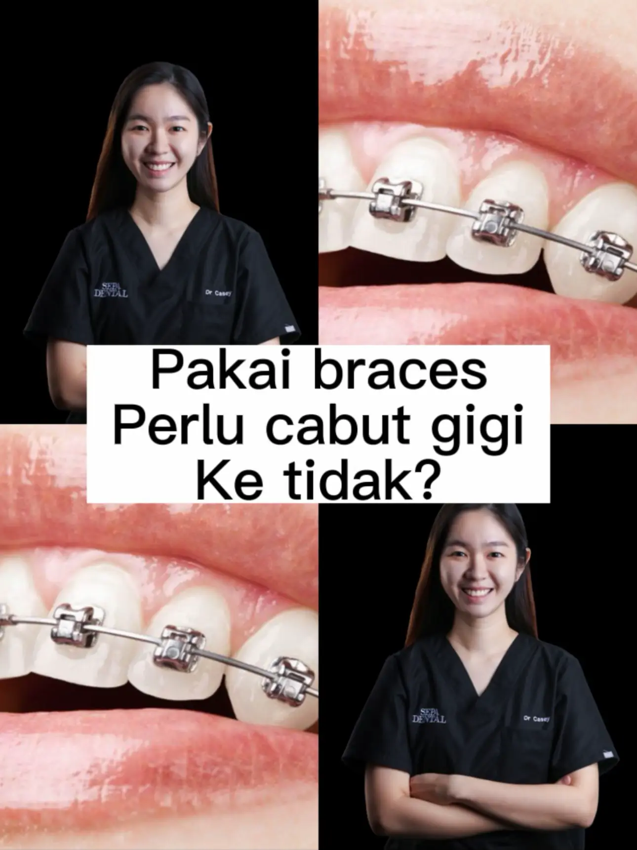 Pakai braces perlu cabut gigi ke tidak? | วิดีโอที่เผยแพร่โดย Sepa Dental | Lemon8