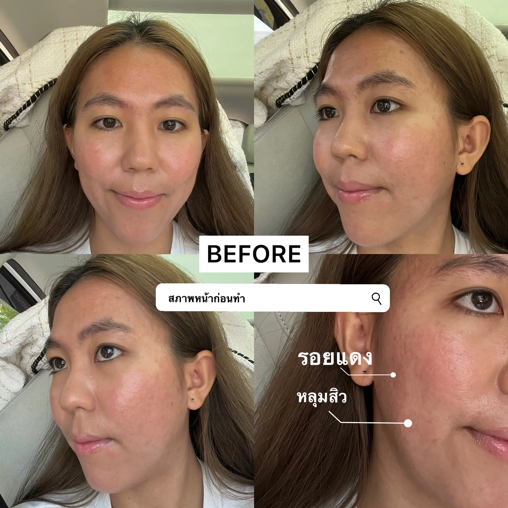 รีวิว Pico Laser+ Meso fat ที่ Dii | แกลเลอรีที่โพสต์โดย Fernnydiaryy ...