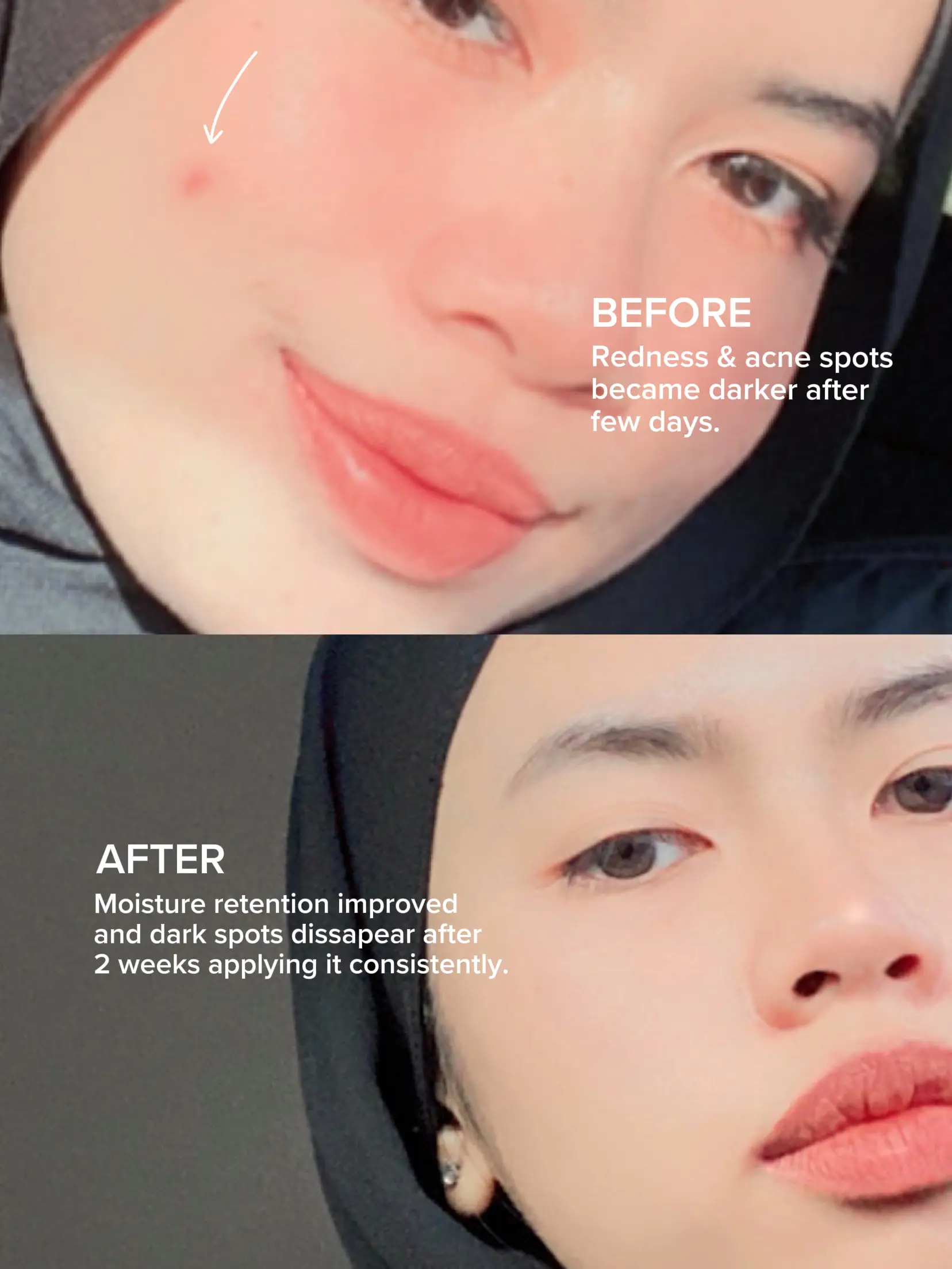 How I Reduce Dark Spot in 2 Weeks 😱 | แกลเลอรีที่โพสต์โดย Ara | Lemon8
