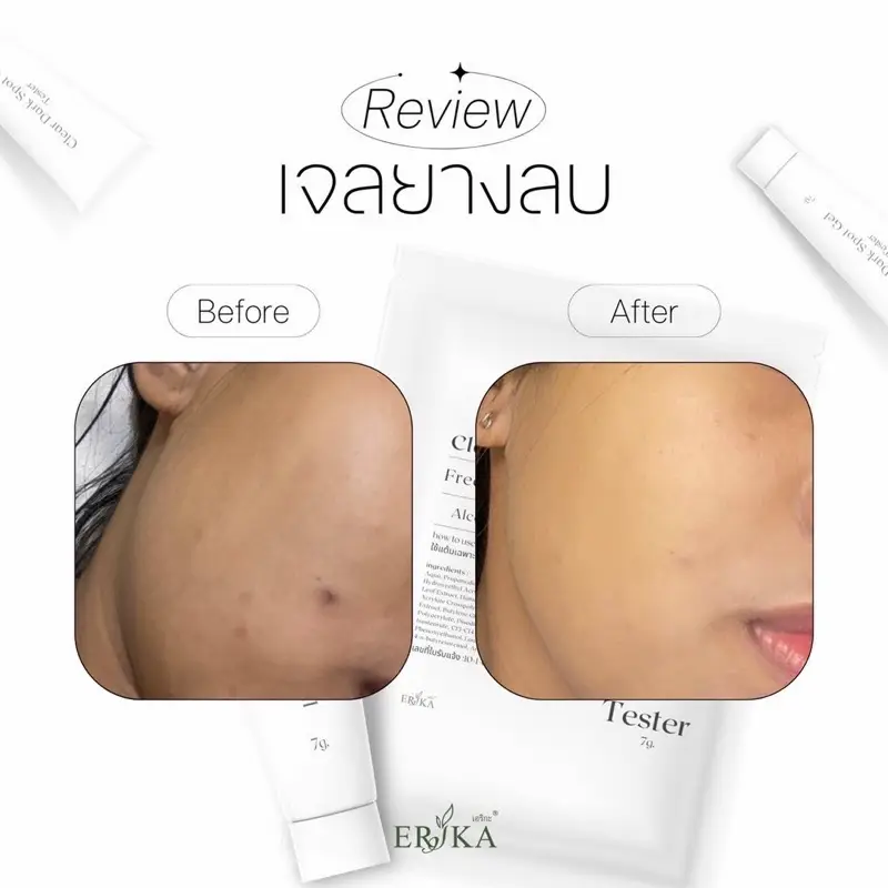 ʕ·ᴥ·ʔ เจลยางลบ ลบรอยสิว | แกลเลอรีที่โพสต์โดย Phatcharin ̈ | Lemon8