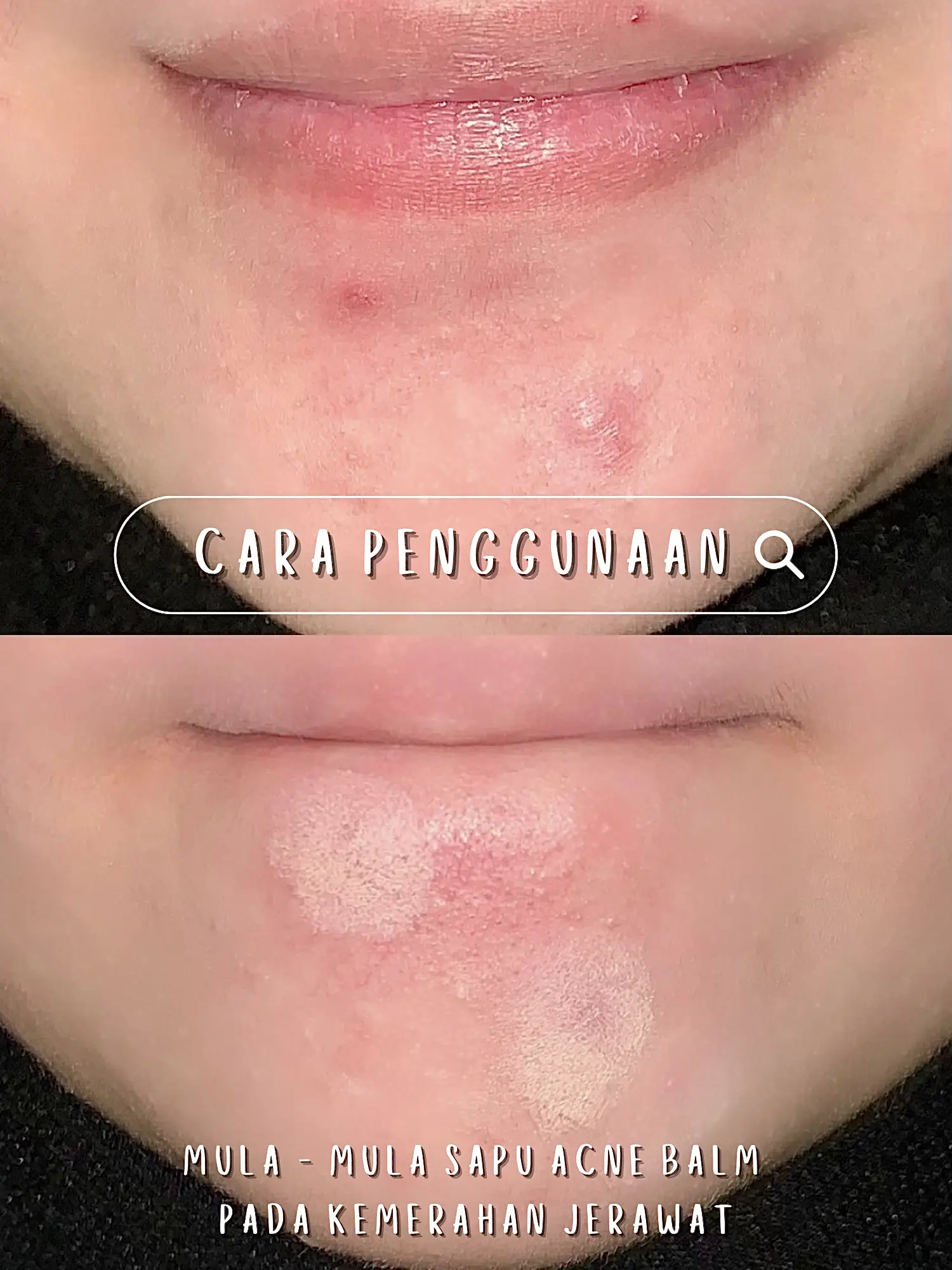 how i do acne treament at home | Galeri disiarkan oleh Yasmin Aminin ...