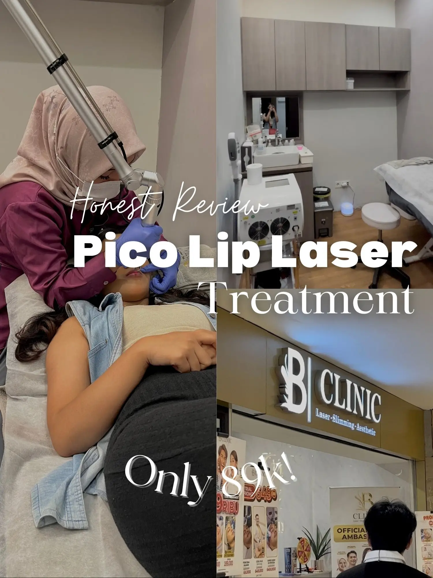 Pertama kali cobain Pico Lip Laser! | Video dipublikasikan oleh Indah rani | Lemon8
