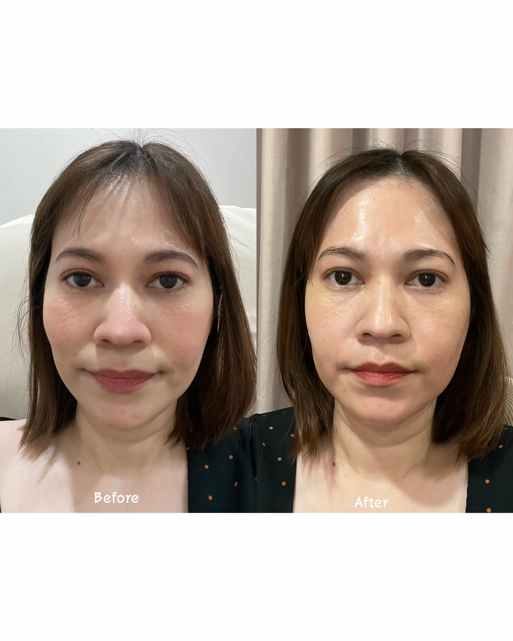 รีวิว ultramax hifu - การค้นหาใน Lemon8