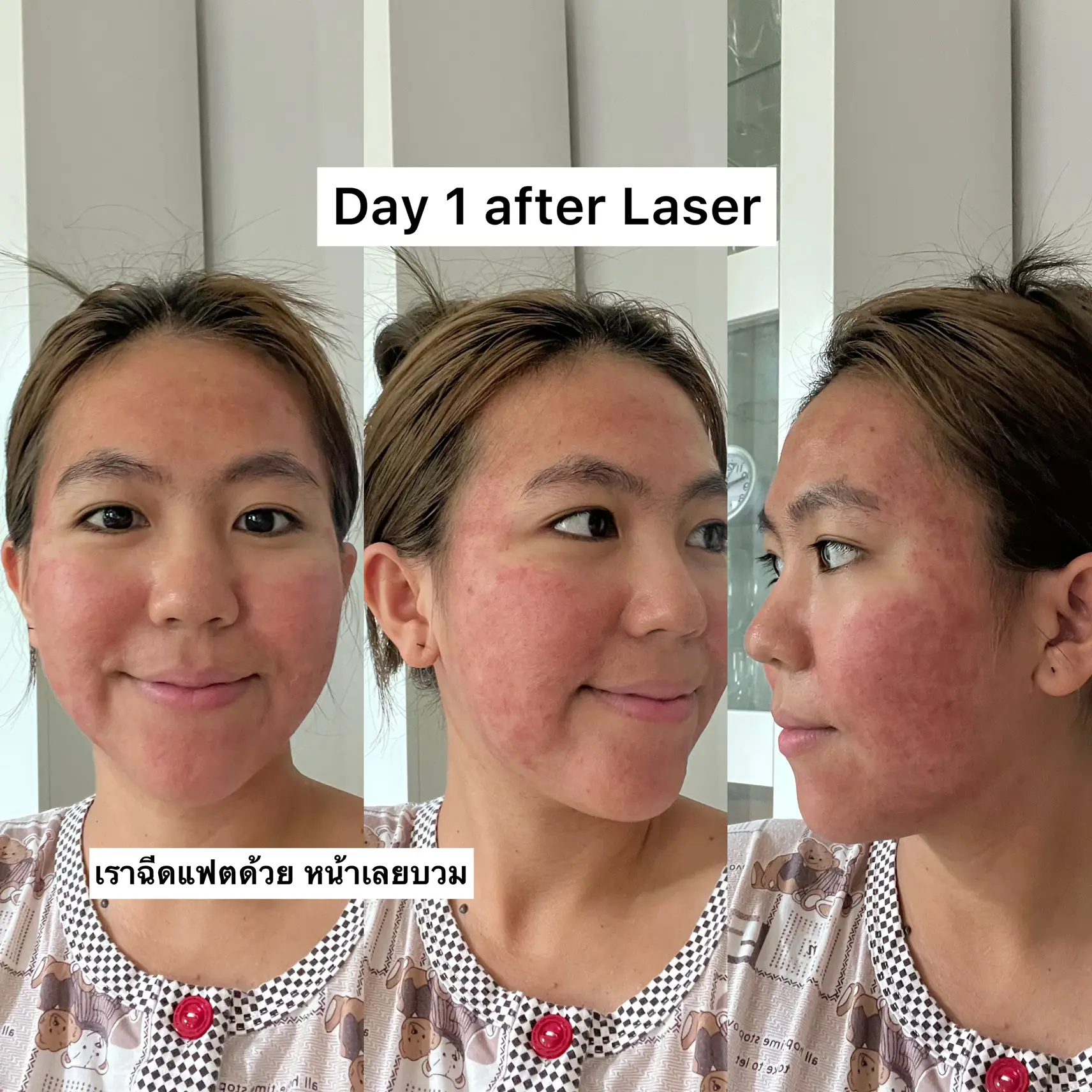 รีวิว Pico Laser+ Meso fat ที่ Dii | แกลเลอรีที่โพสต์โดย Fernnydiaryy ...