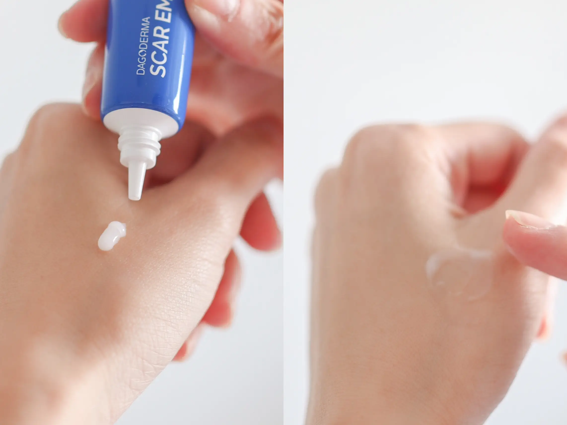 สยบรอยแผลดูดไขมันด้วย Dagoderma Scar Emulgel | แกลเลอรีที่โพสต์โดย May ...