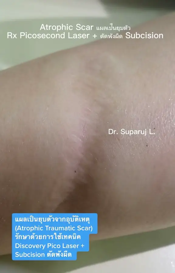 รักษาแผลเป็นยุบตัวจากอุบัติเหตุ (Atrophic Traumatic Scar) | วิดีโอที่ ...
