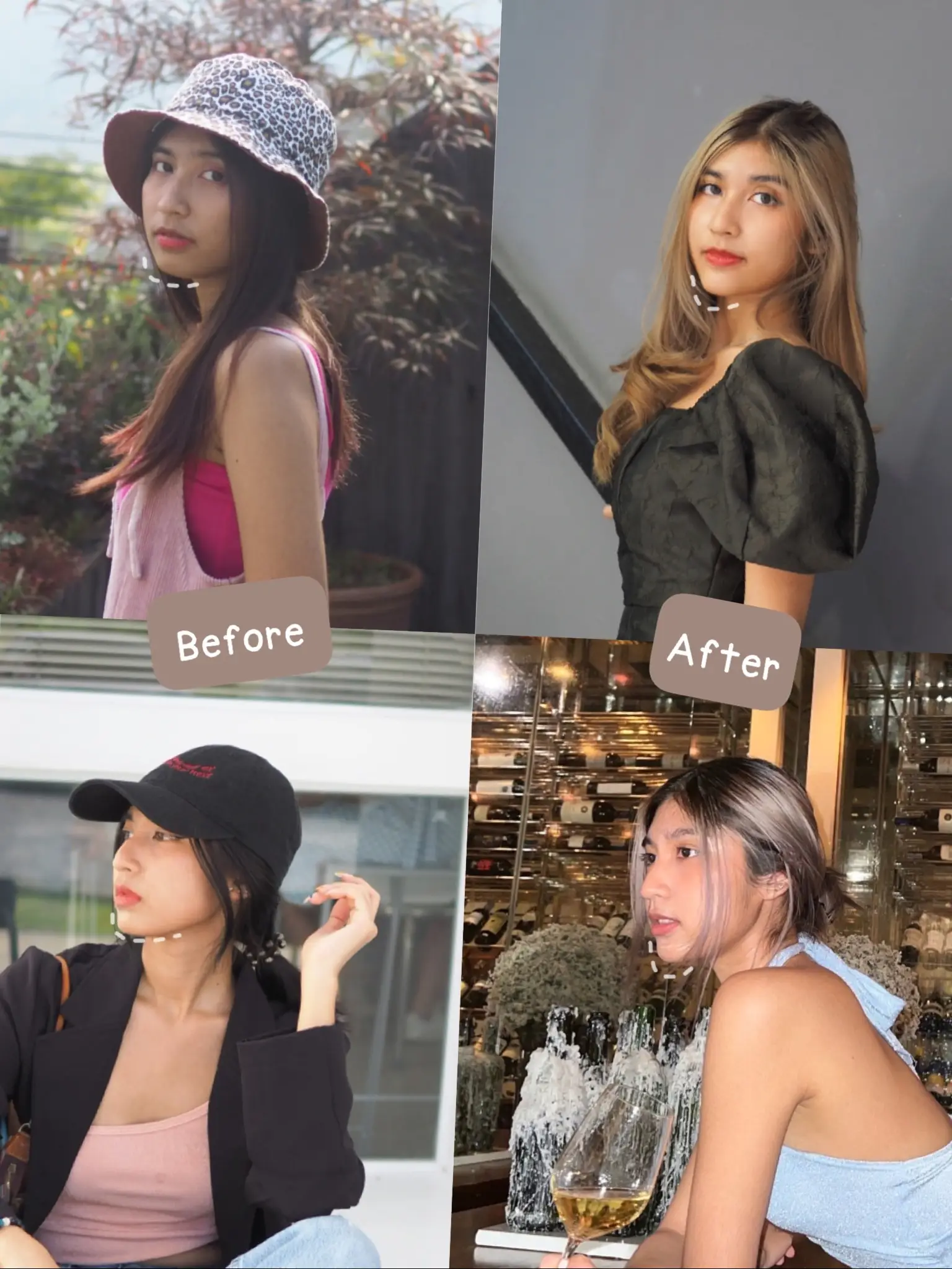 รีวิวศัลยกรรม (เสริมคาง) ครั้งแรก!!!!💖 | แกลเลอรีที่โพสต์โดย beem | Lemon8