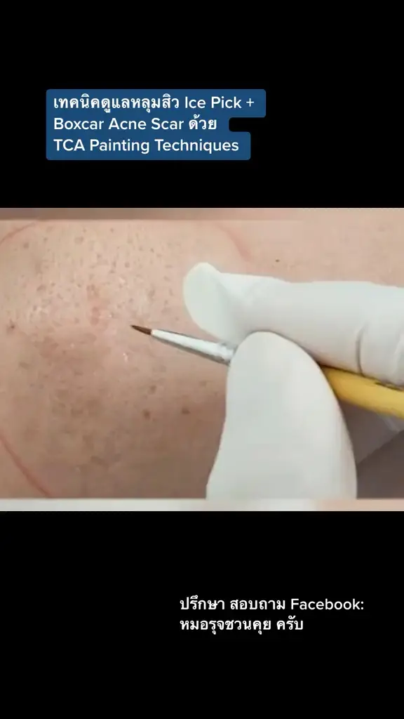 Treat Deep Acne Pit Ice Pick Boxcar Scar With TCA Painting | Video ...