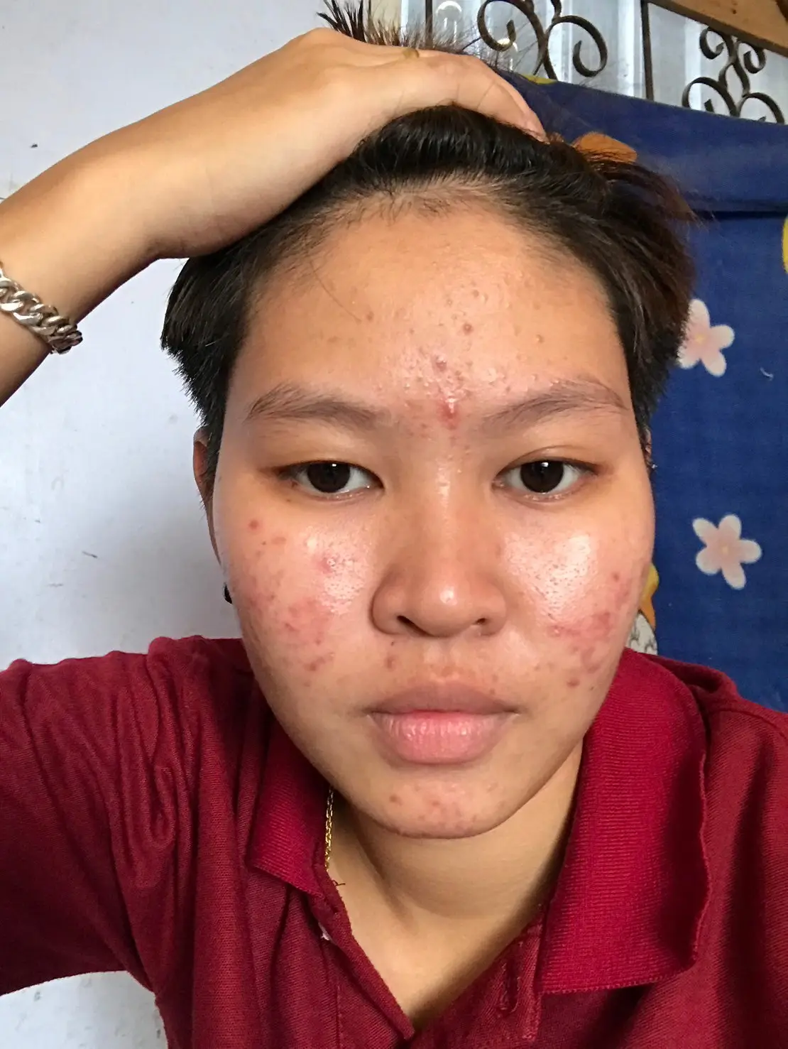 รักษาผิวระคายเคือง - การค้นหาใน Lemon8