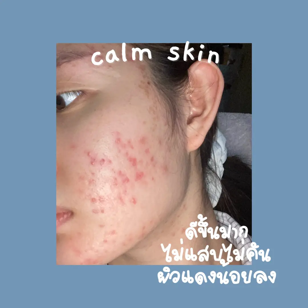 Tretinoin and Hyperpigmentation - การค้นหาใน Lemon8