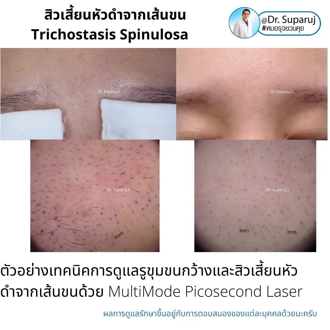 Black-headed splinter wide pore from Trichostasis spinulosa hair line ...