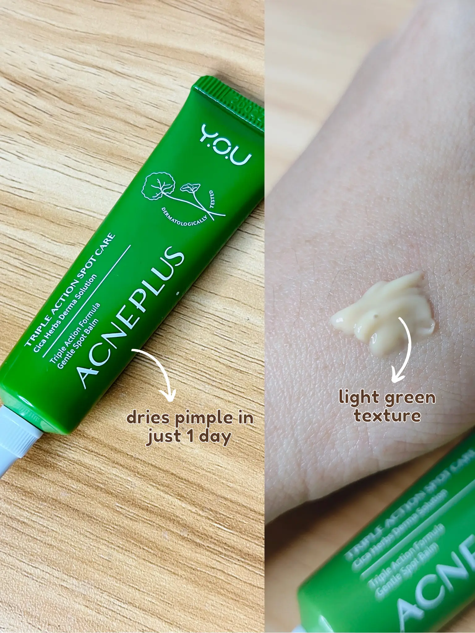 Acne Spot Cream Which one is effective? | Gallery posted by Ashy ...