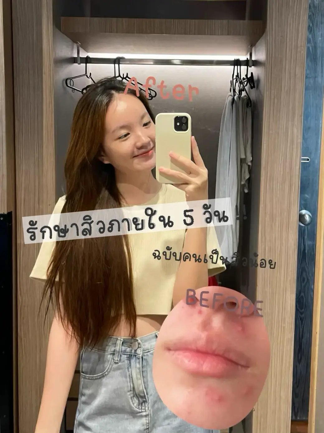 รักษาสิวใน 5 วัน (ฉบับสิวไม่เยอะ) 🌟 | แกลเลอรีที่โพสต์โดย mp | Lemon8