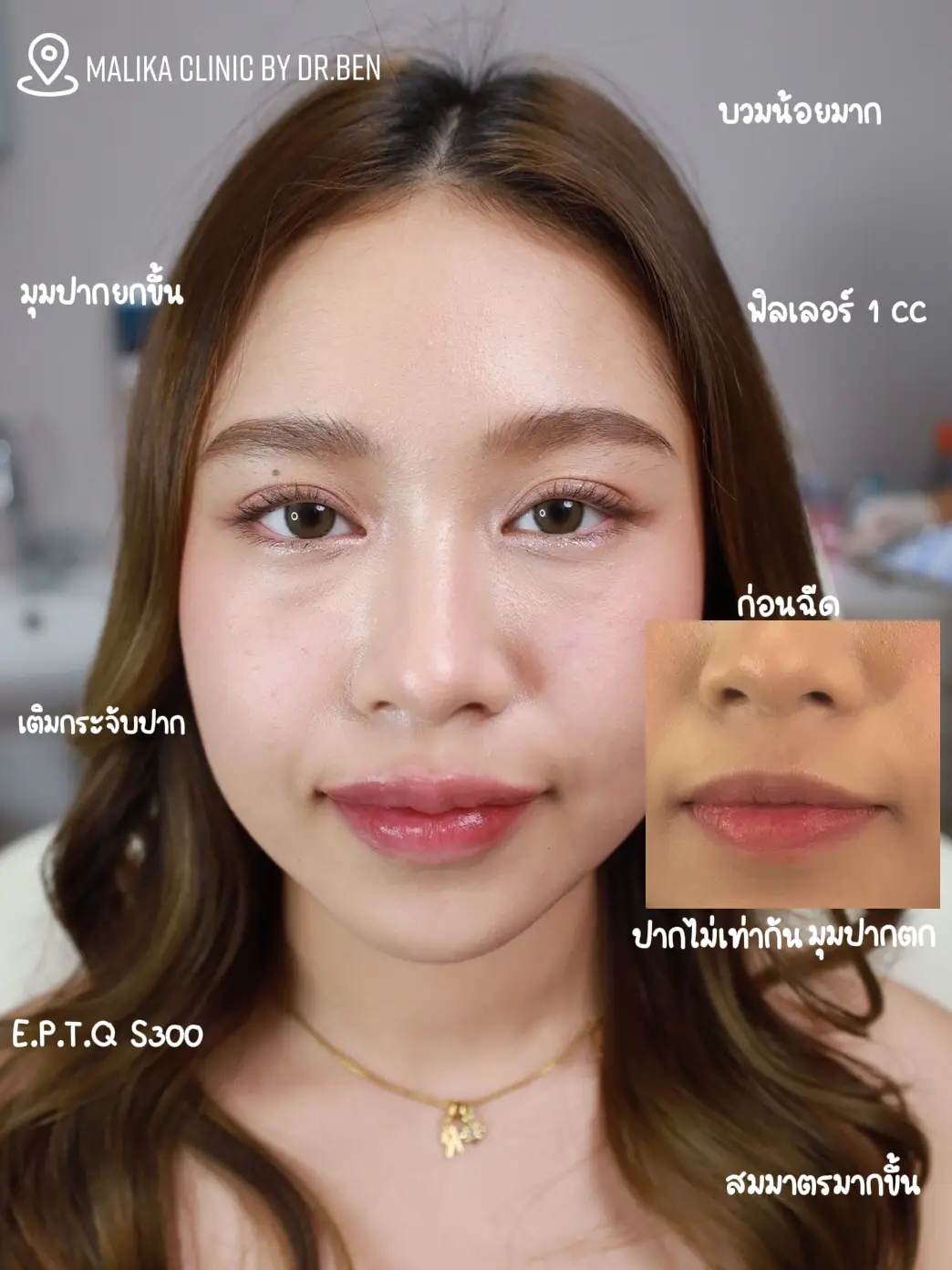 รีวิวฉีดฟิลเลอร์ปาก E.P.T.Q S300 โดยคุณหมอเบญ | Gallery posted by Malika Clinic | Lemon8