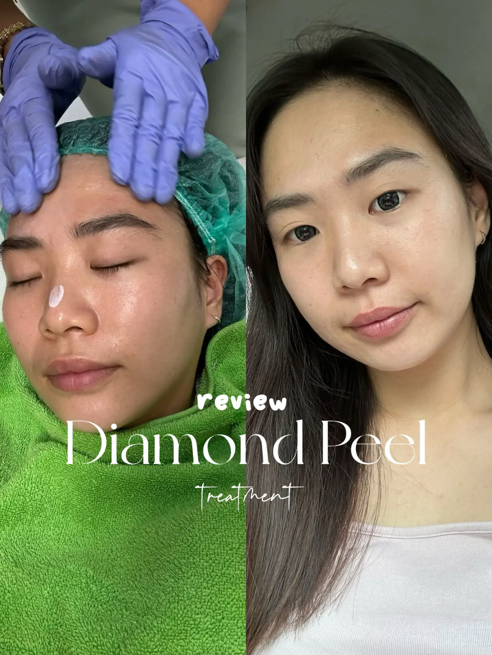 DIAMOND PEEL 💎 gak perih sama sekali!! | Galeri diposting oleh 𝙘𝙞𝙣𝙣𝙘𝙮 ...