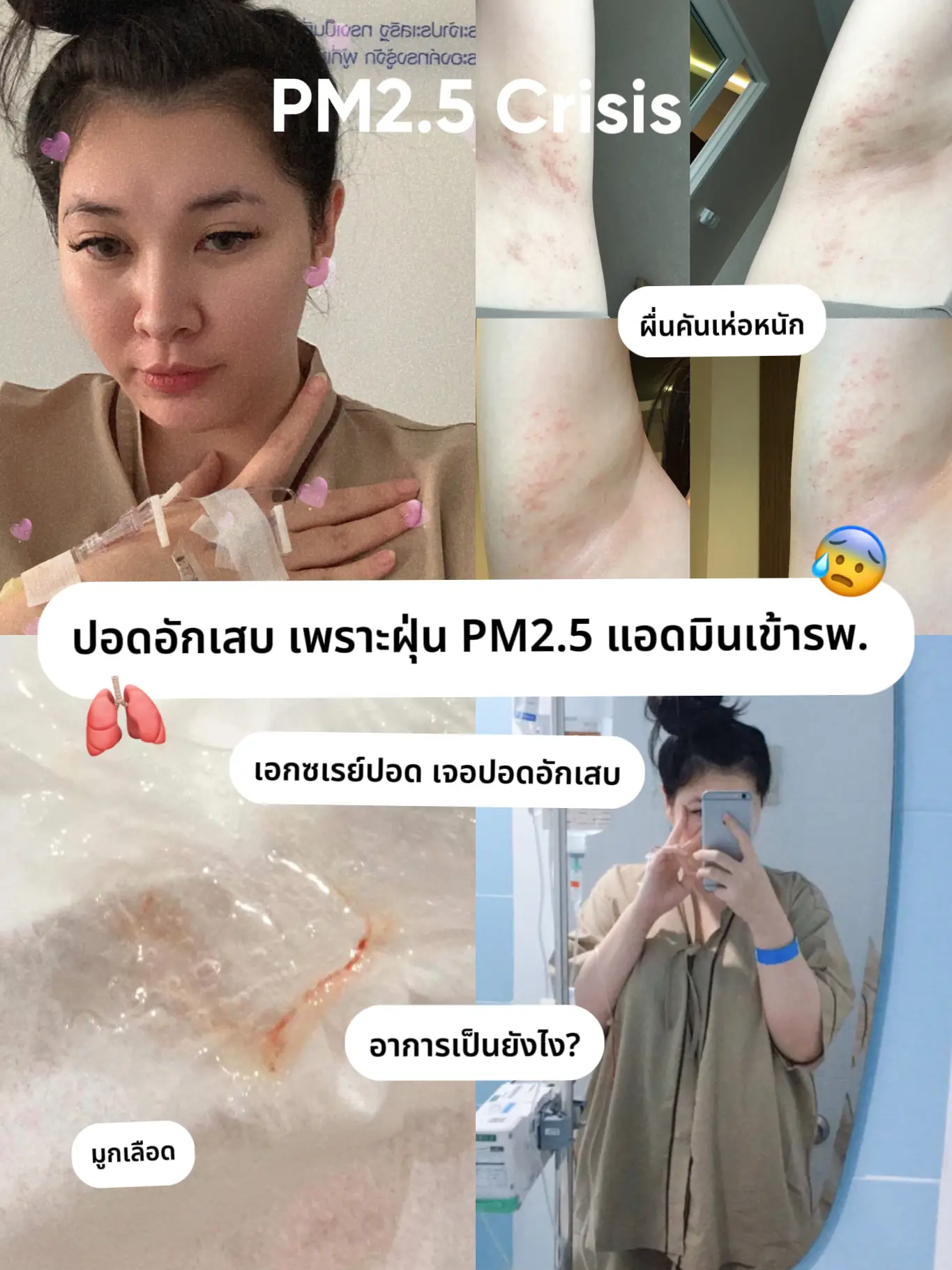🫁😰เชียงใหม่ ปอดอักเสบไม่รู้ตัว ฝุ่น PM2.5 น่ากลัวกว่าที่เราคิด | แกลเลอรีที่โพสต์โดย Yokmoki ...