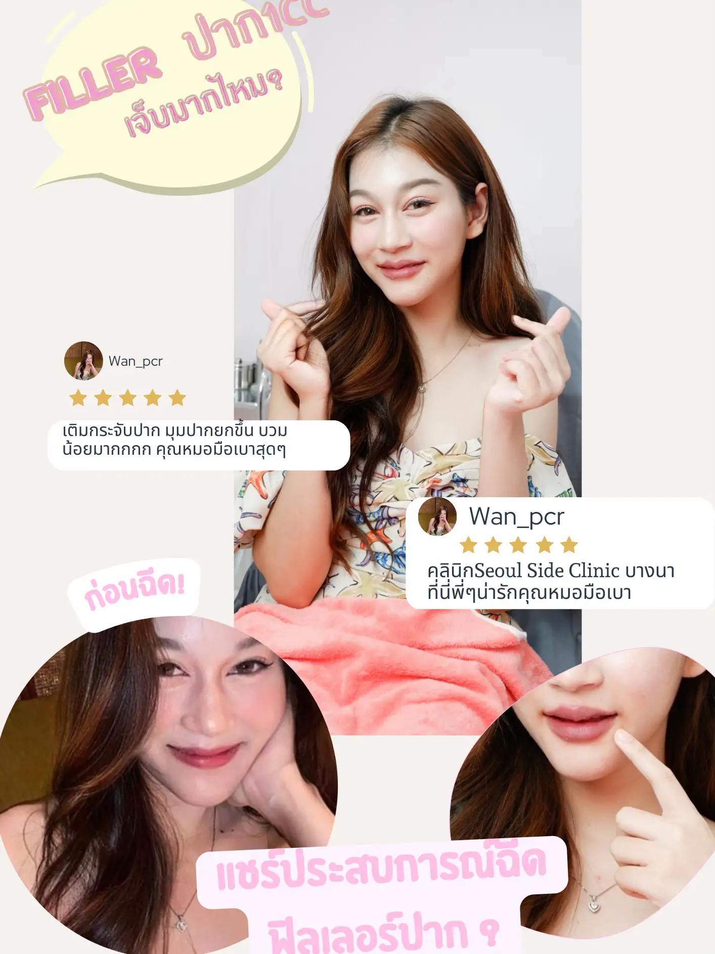 ประสบการณ์การฉีดฟิลเลอร์! | แกลเลอรีที่โพสต์โดย Wan_pcr | Lemon8