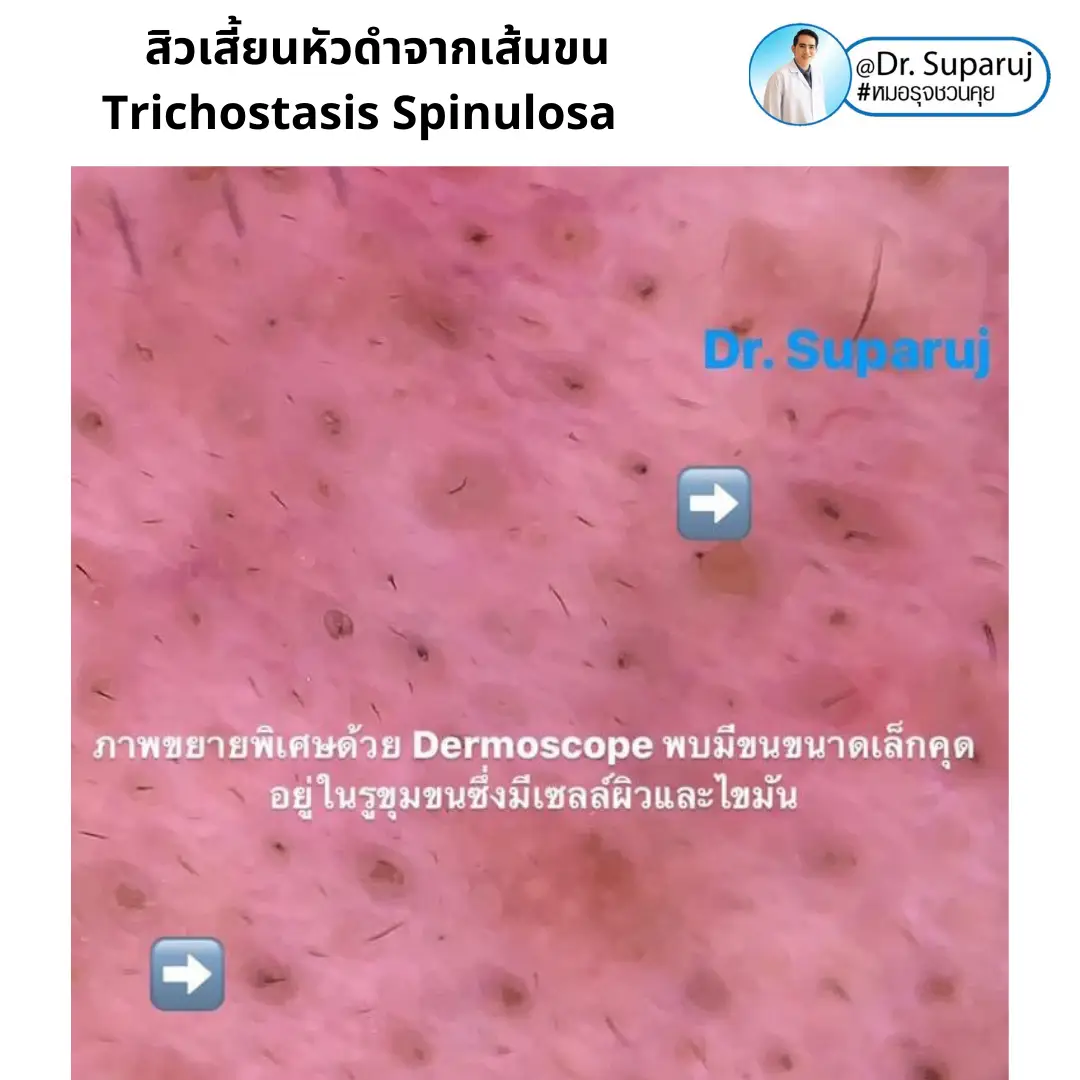 Black-headed splinter wide pore from Trichostasis spinulosa hair line ...