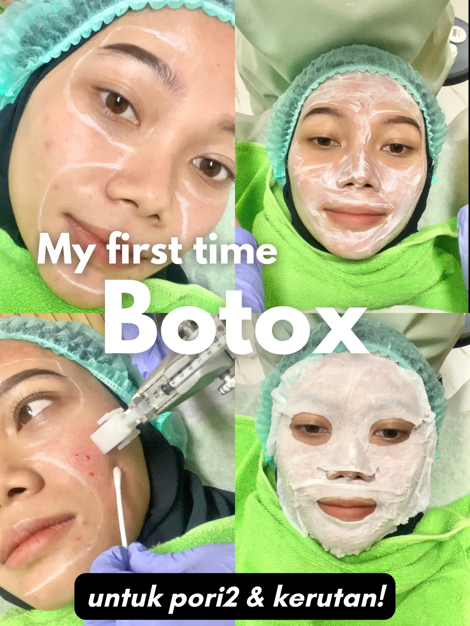 Botox untuk ngecilin pori2 | Video dipublikasikan oleh Stiamellia | Lemon8