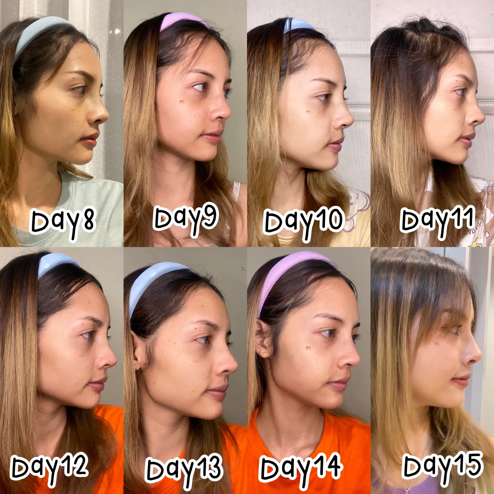 รีวิวศัลยกรรมเสริมจมูกครั้งแรก EMMA Clinic | แกลเลอรีที่โพสต์โดย Mint Chali | Lemon8