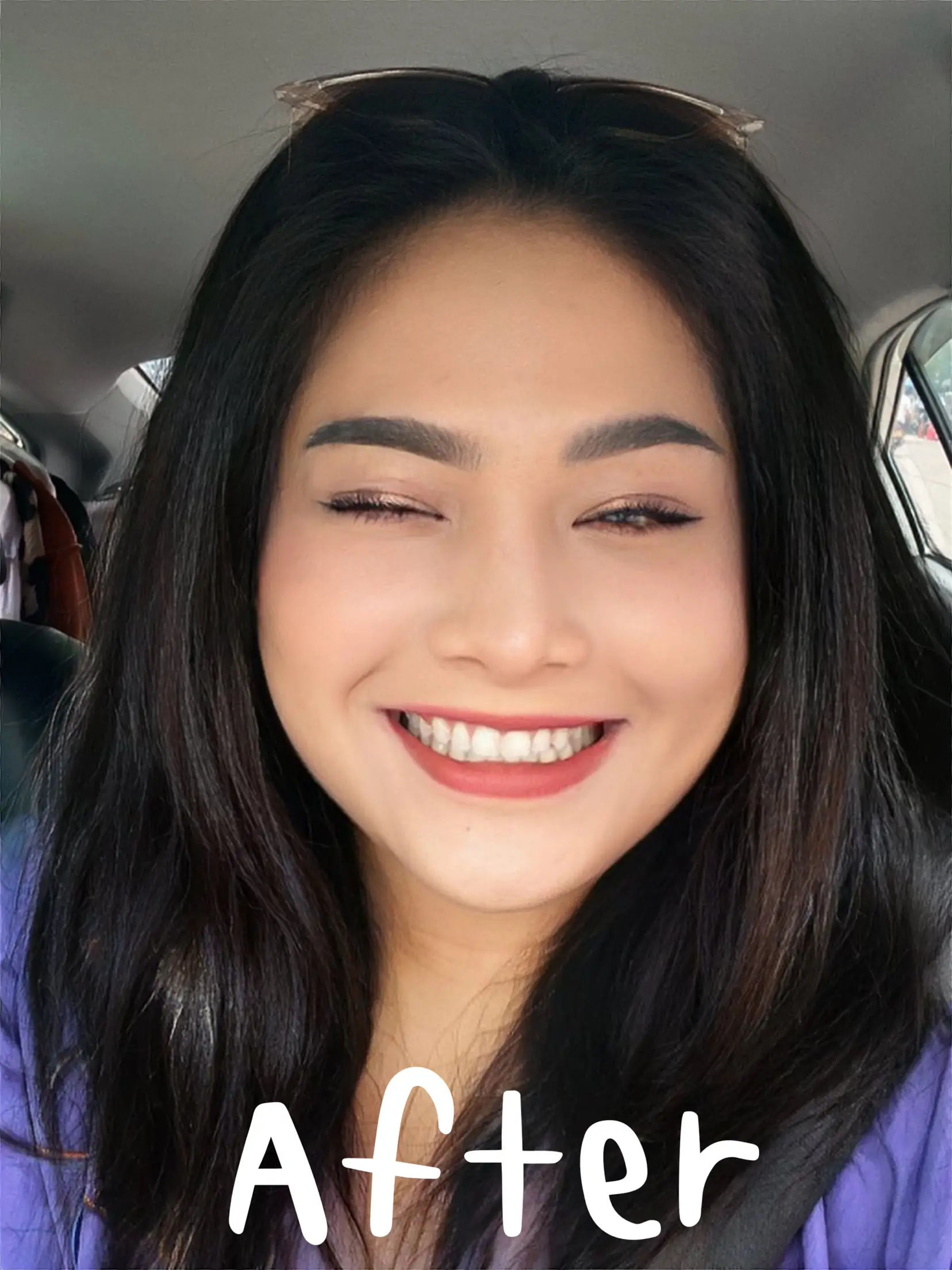 แจกพิกัดคลินิก ทำฟัน จัดฟัน ดัดฟัน ย่านรังสิต - คลองสาม 👩🏻‍⚕️ | แกลเลอรีที่โพสต์โดย JaJah | Lemon8