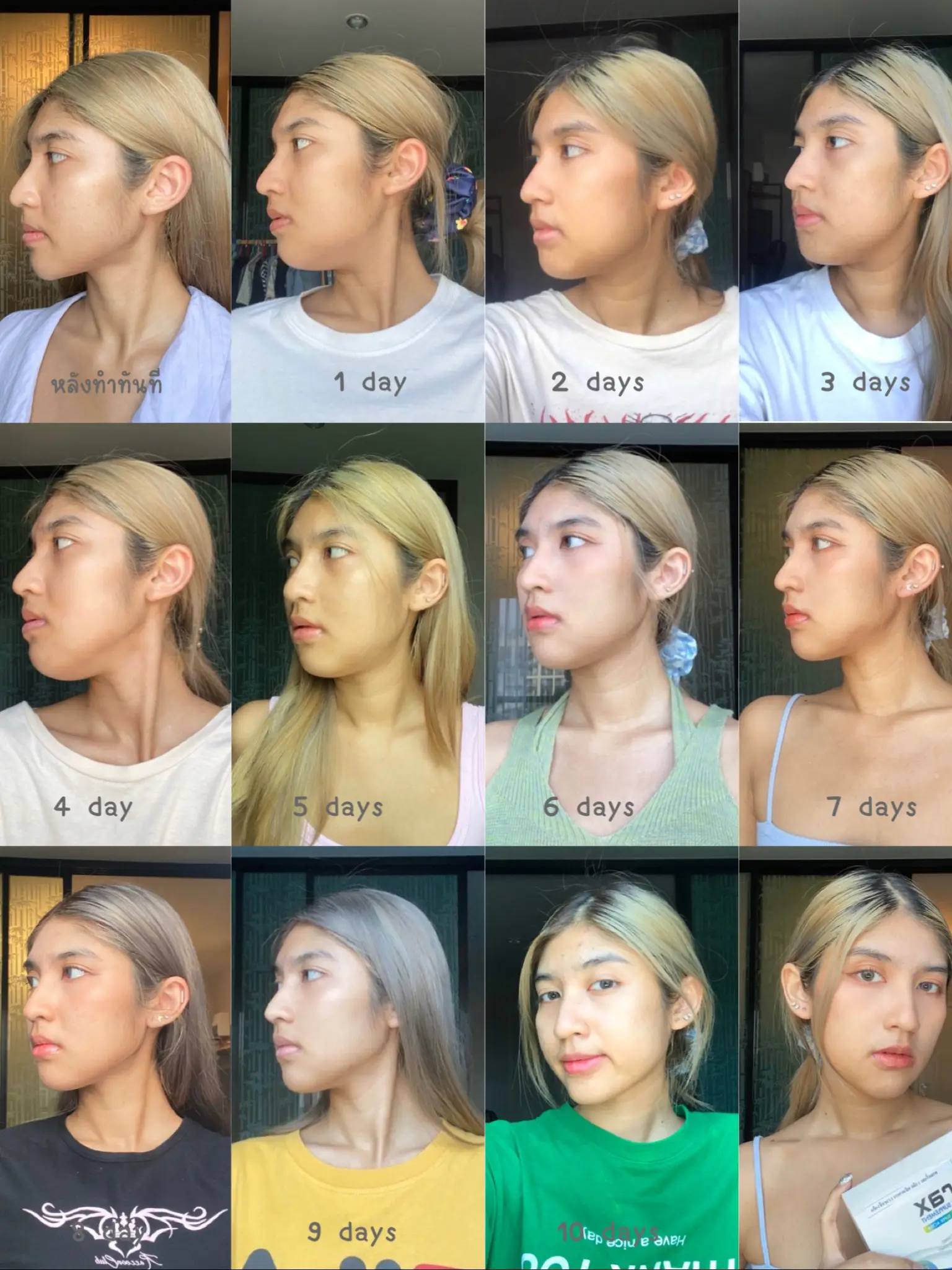 รีวิวศัลยกรรม (เสริมคาง) ครั้งแรก!!!!💖 | แกลเลอรีที่โพสต์โดย beem | Lemon8