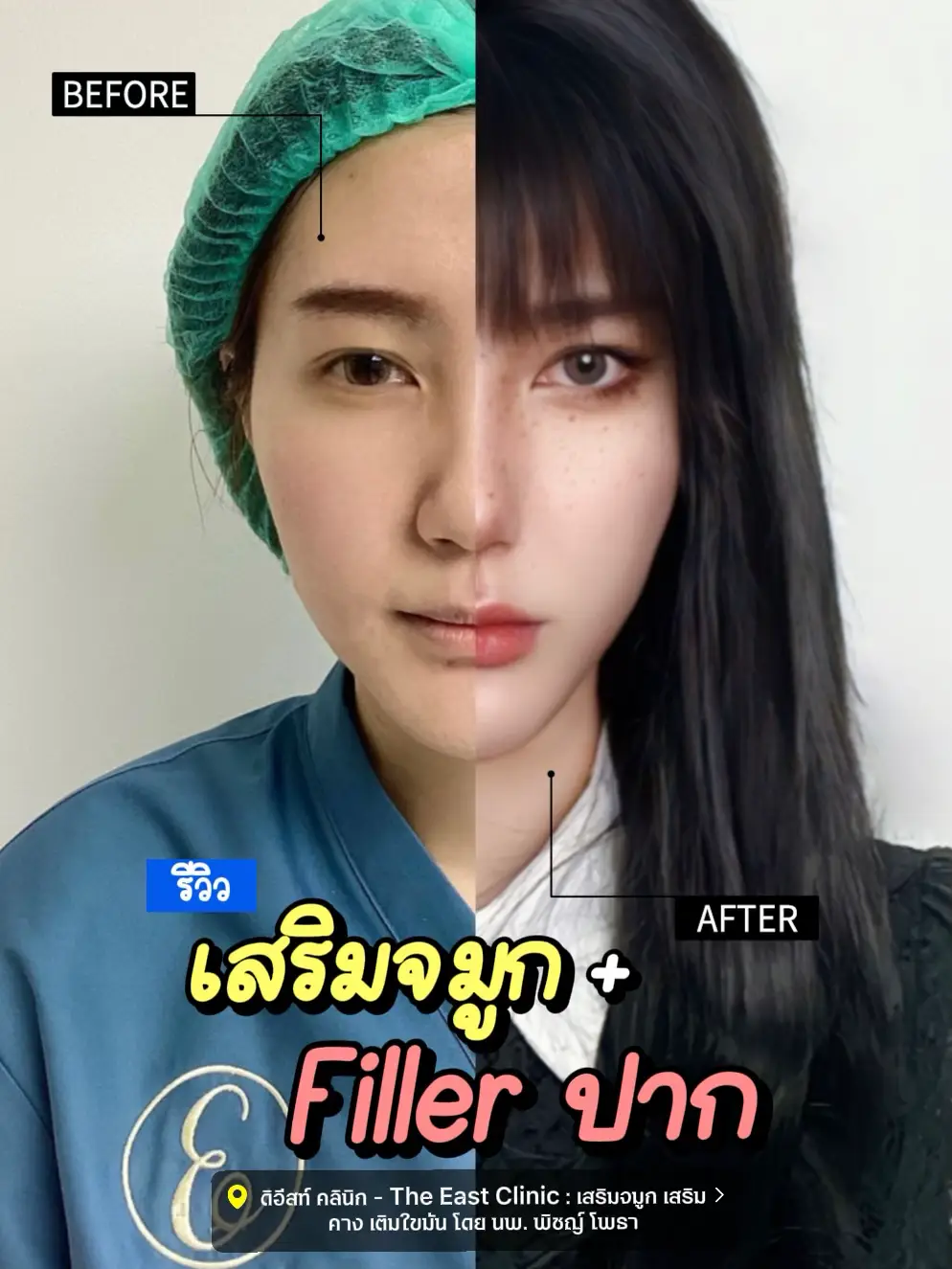 [รีวิว] เสริมจมูก + Filler ปาก ครั้งแรก!! | แกลเลอรีที่โพสต์โดย a.jelo_ | Lemon8