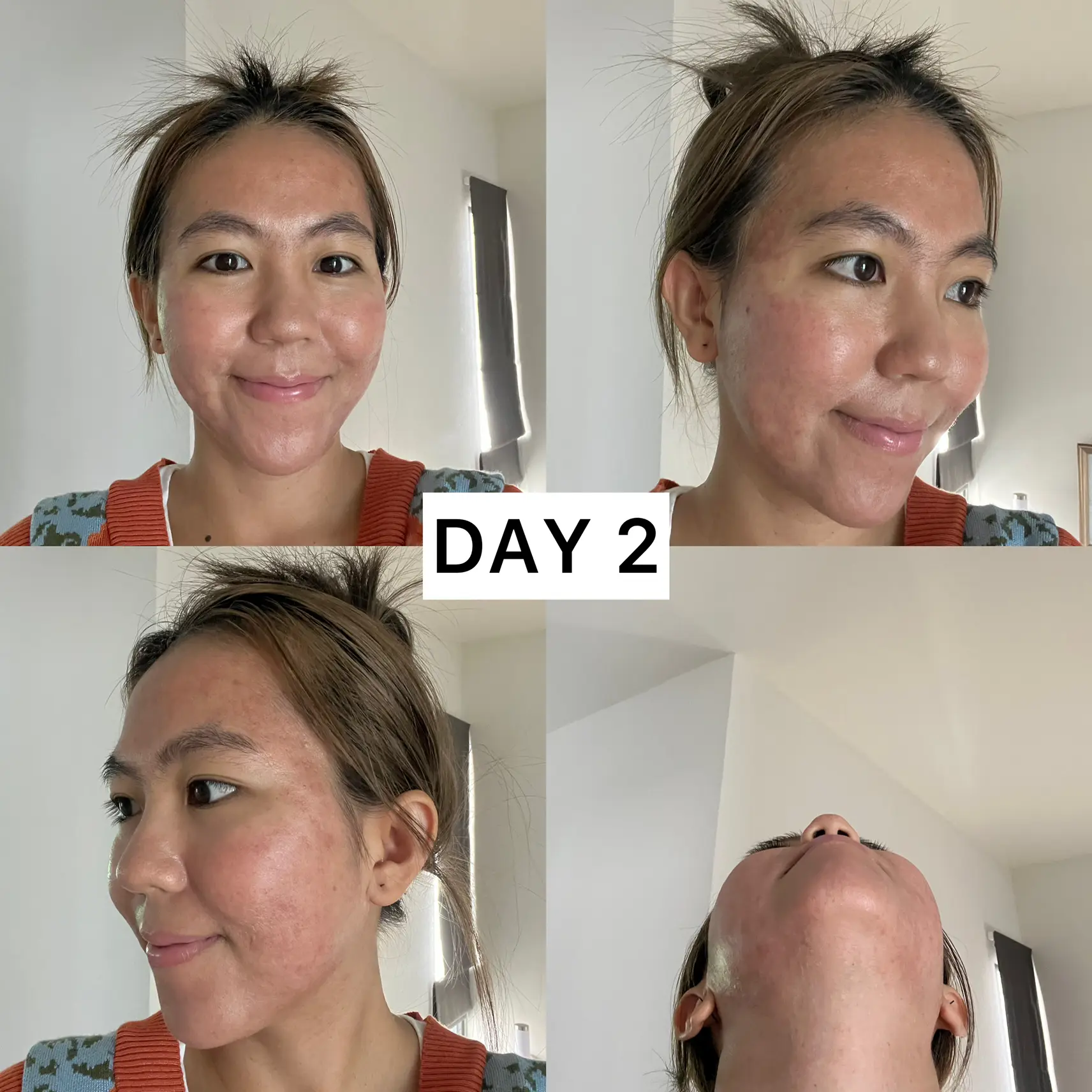 รีวิว Pico Laser+ Meso fat ที่ Dii | แกลเลอรีที่โพสต์โดย Fernnydiaryy ...